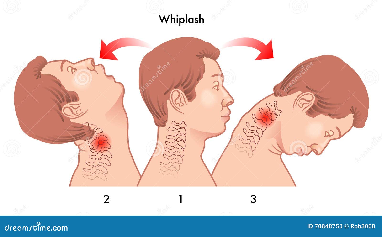 Contusão ilustração do vetor. Ilustração de frente, carro - 70848750