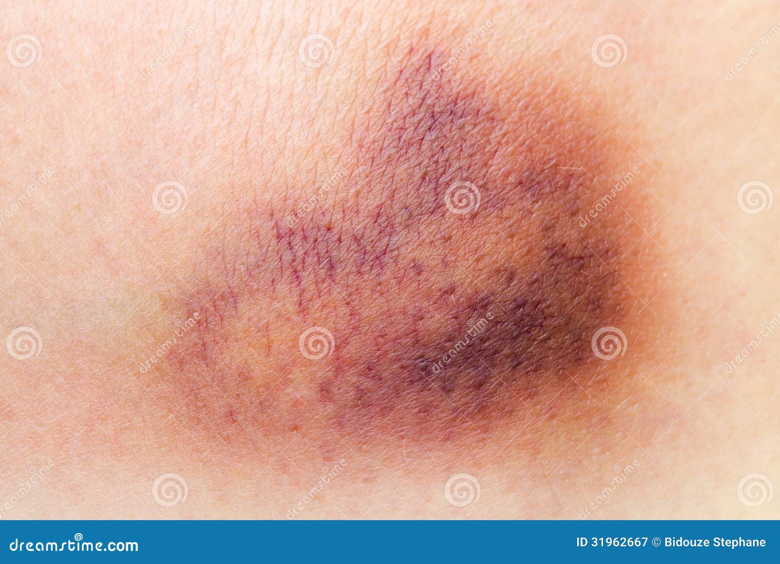 Contusión En Piel Fotografía de archivo libre de regalías - Imagen ...