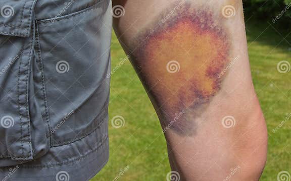 Contusion grave photo stock. Image du sports, dommages - 20580846