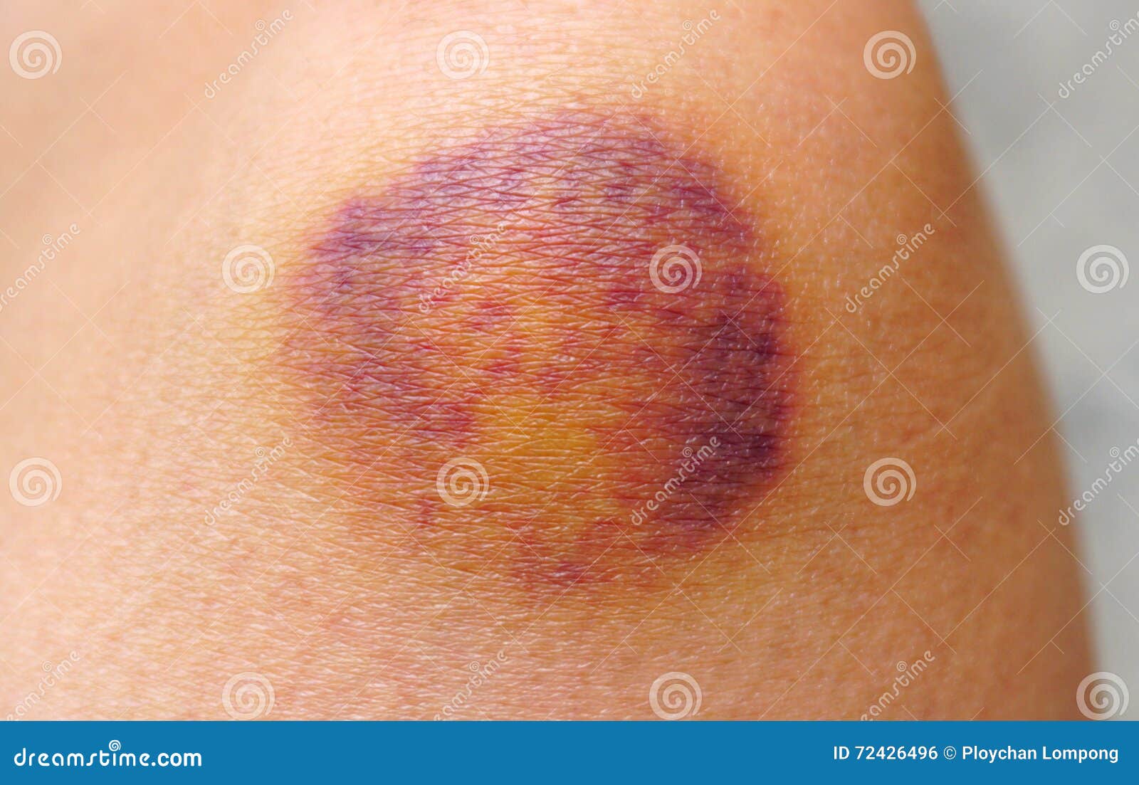 Cid Ferimento Corto Contuso Pé - RETOEDU