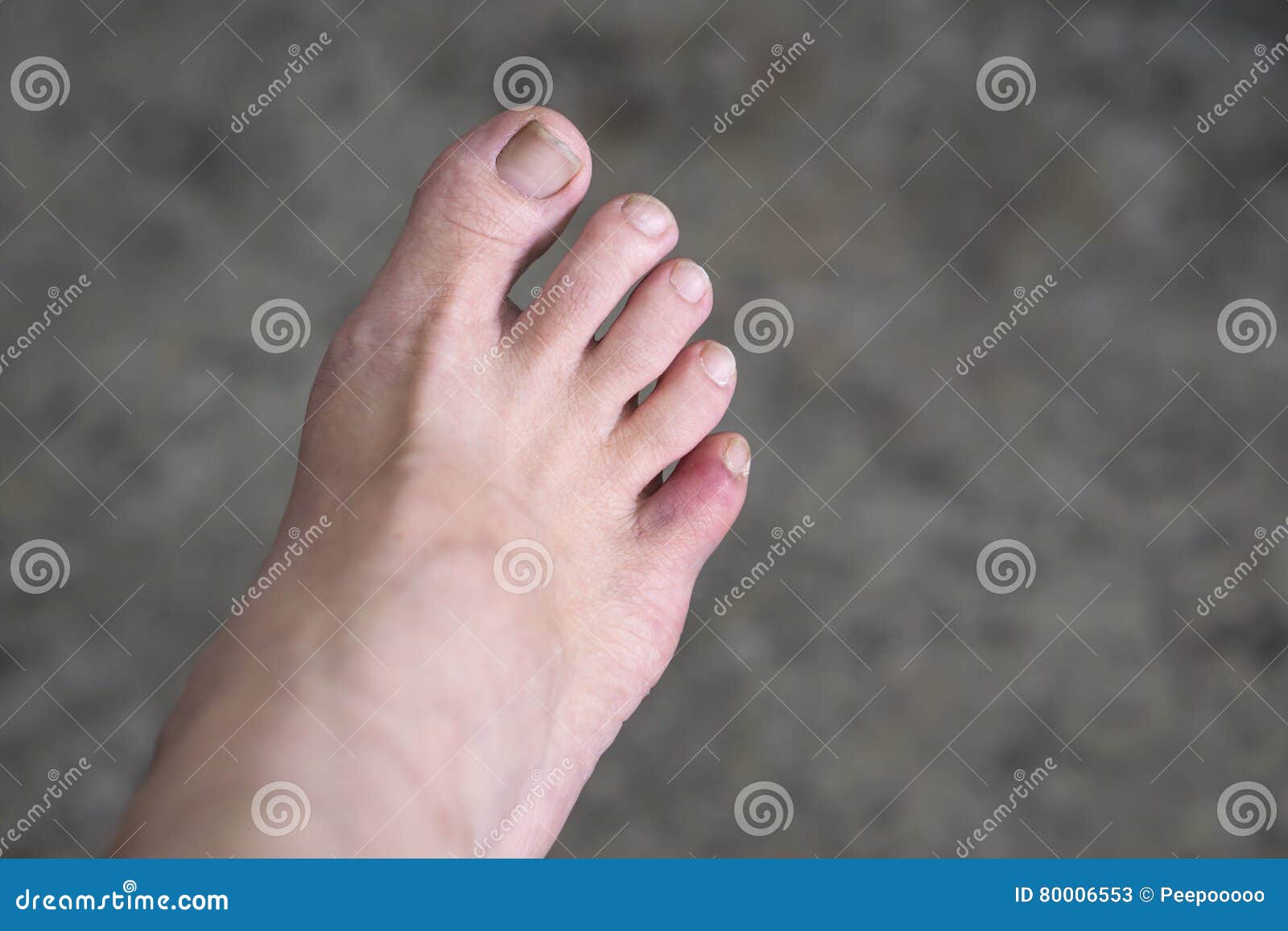 Contusiones En El Dedo Del Pie De La Mujer Imagen de archivo - Imagen ...