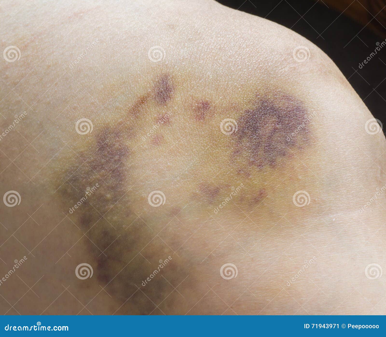 Contusiones En La Pierna De La Mujer Imagen de archivo - Imagen de ...