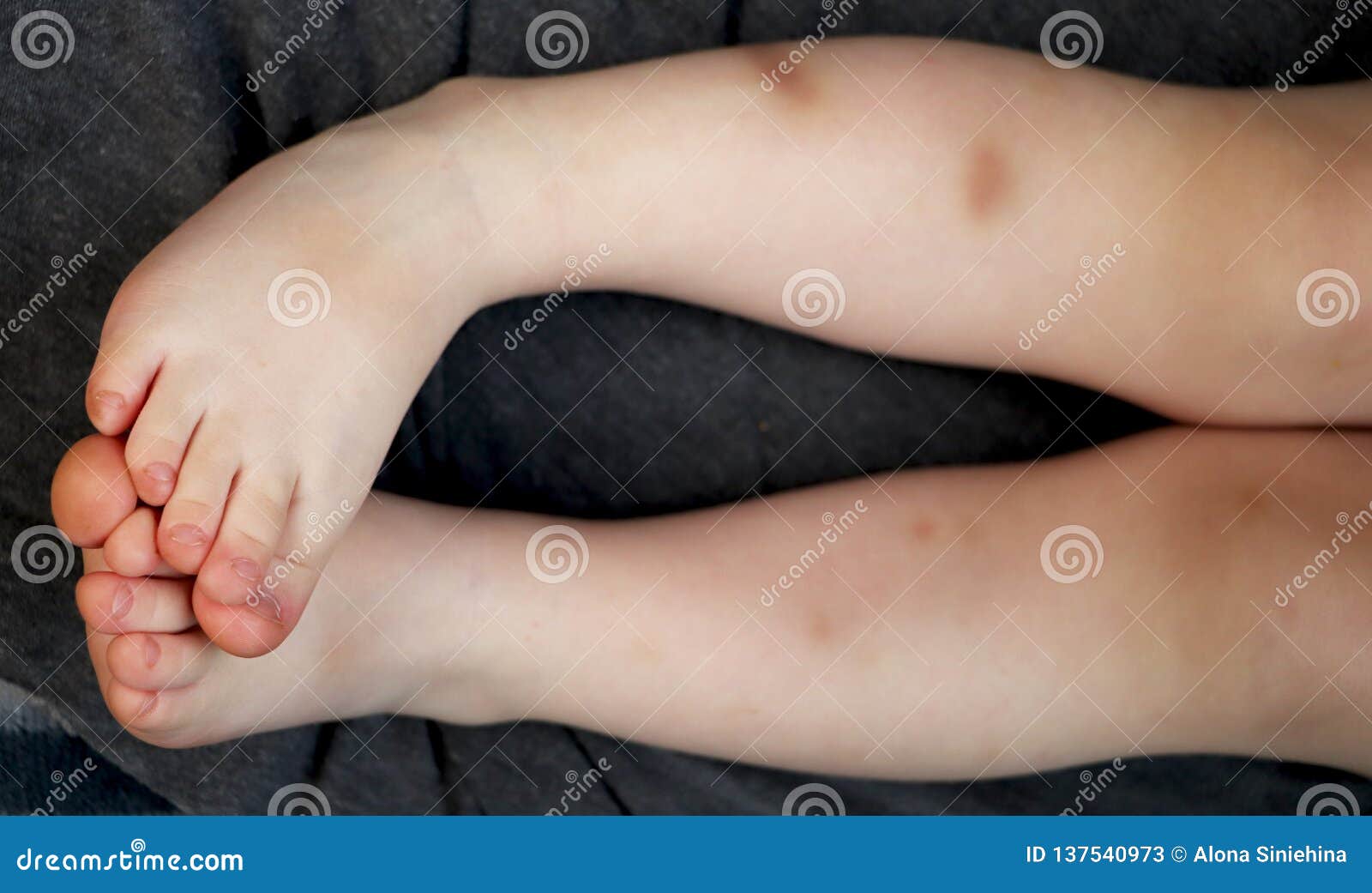 Contusiones En Las Piernas Del Muchacho Imagen de archivo - Imagen de ...