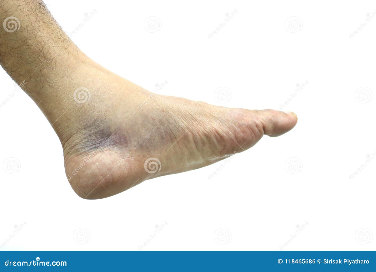 Contusions Photos Stock - Téléchargez 1,040 Photos libres de droits