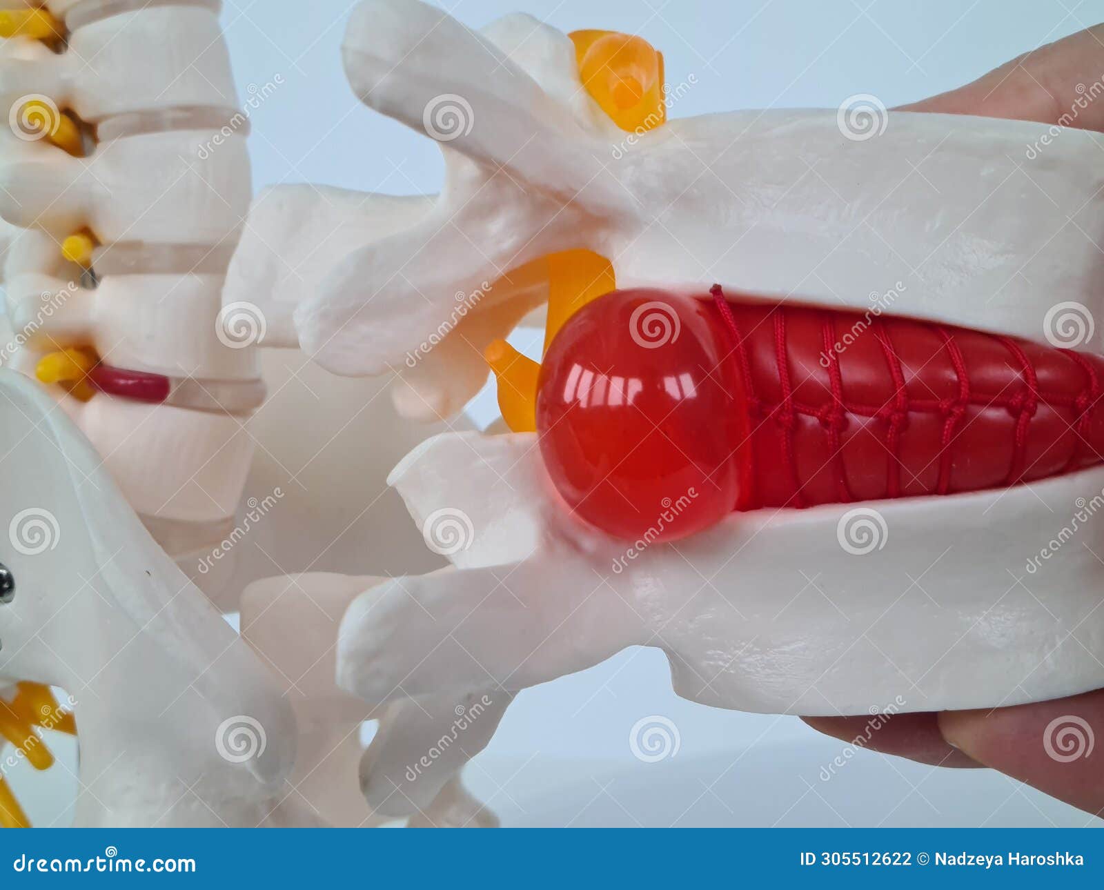 Convex Red Intervertebral Disc Herniation on Model of Spine Stock Photo ...