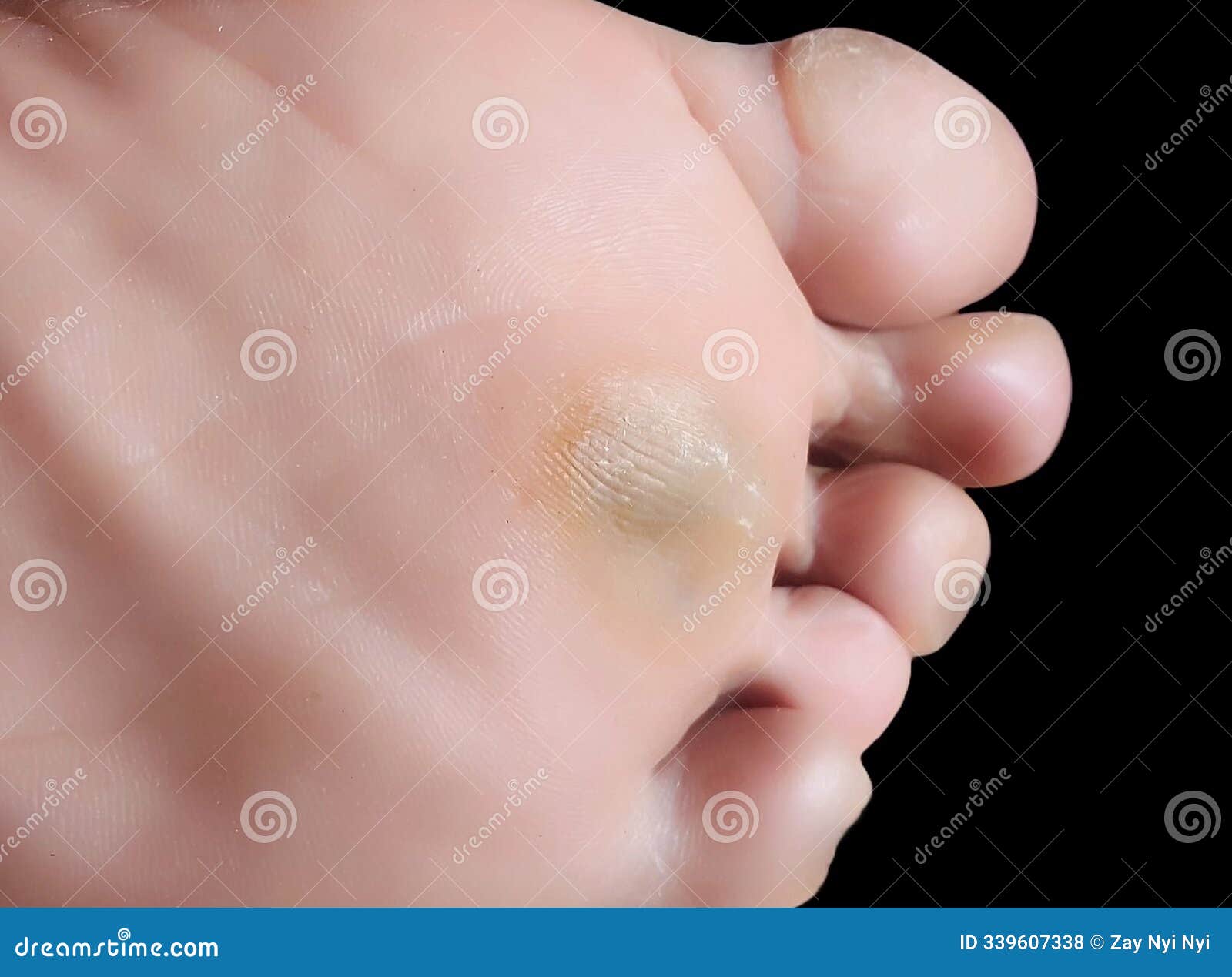 Corn or callus at the foot stock photo. Image of injury - 339607338