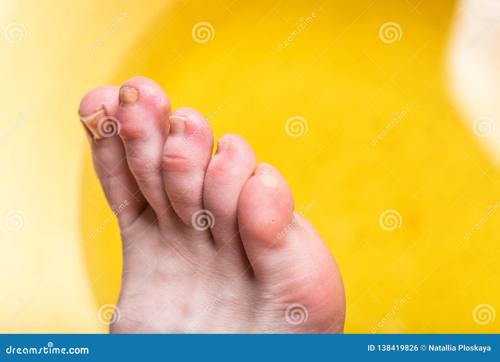 Corn or Clavus on Female Foot. Stock Photo - Image of painful, skin ...