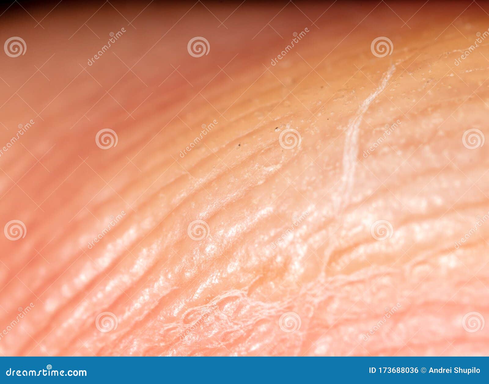 Corn on the Finger As a Background Stock Photo - Image of hand, wound ...