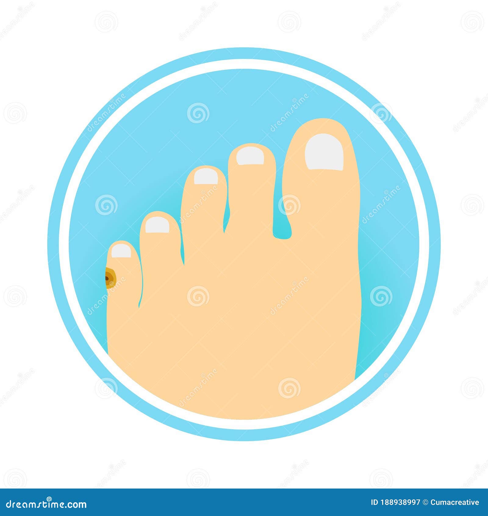 Corn on Left Pinky Toe. Vector Illustration Stock Vector - Illustration ...