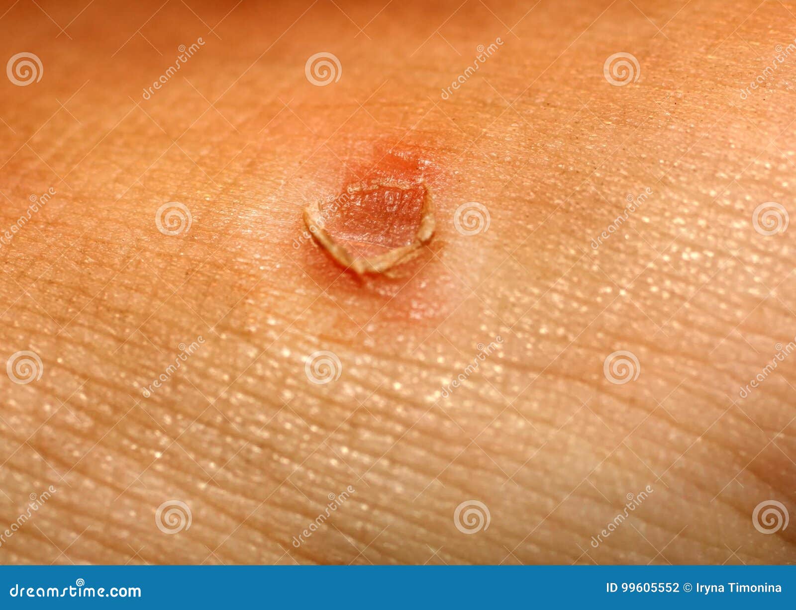 Corn on the Skin. the Corn Popped. Stock Photo - Image of finger ...