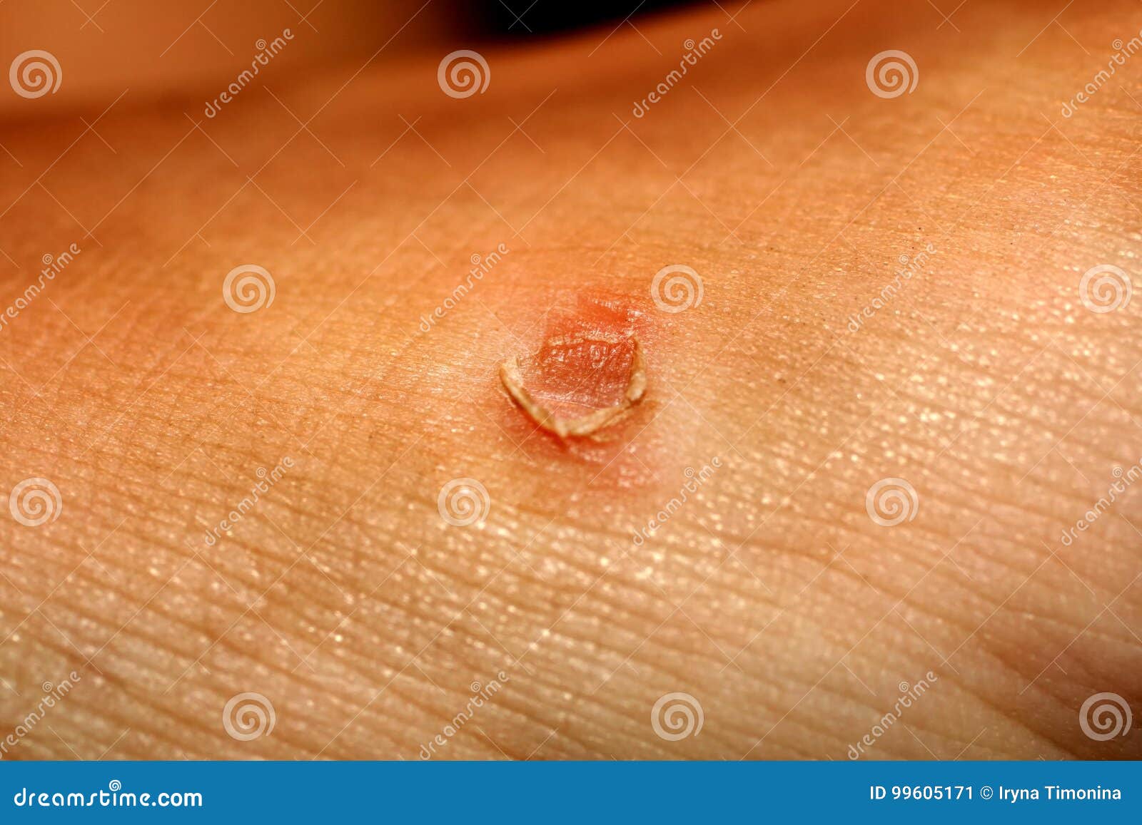Corn on the Skin. the Corn Popped. Stock Image - Image of barefoot ...
