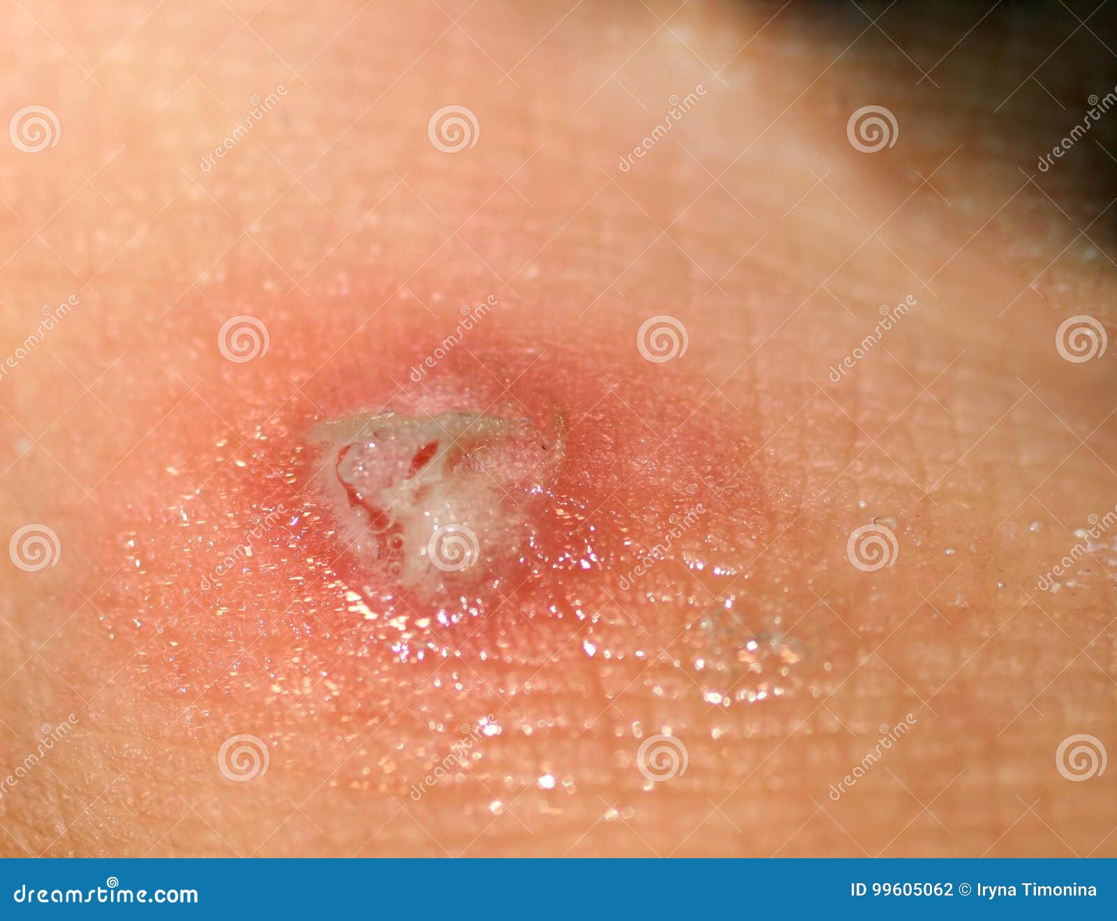 Corn on the Skin. the Corn Popped Stock Photo - Image of medical ...