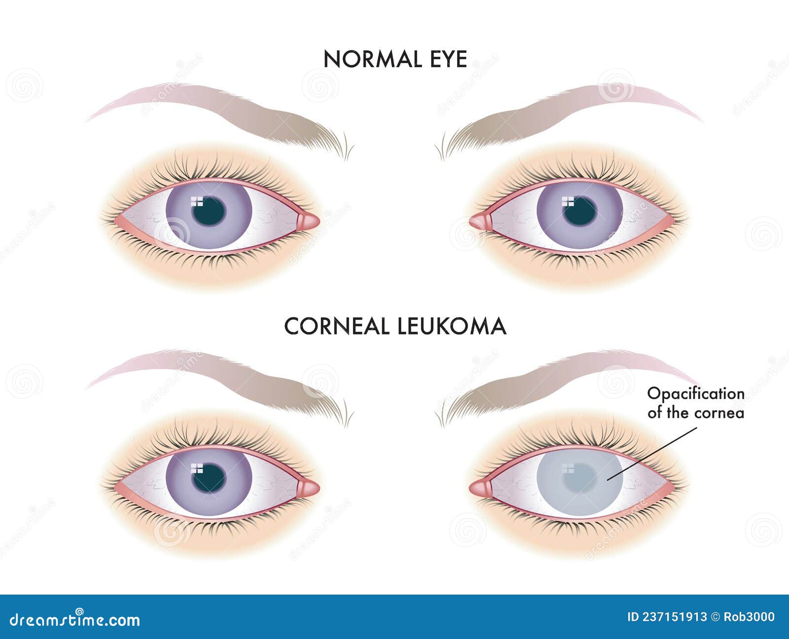 Corneal Leukoma Illustration Stock Vector - Illustration of borders ... Corneal Leukoma Illustration Stock Vector - Illustration of borders ...