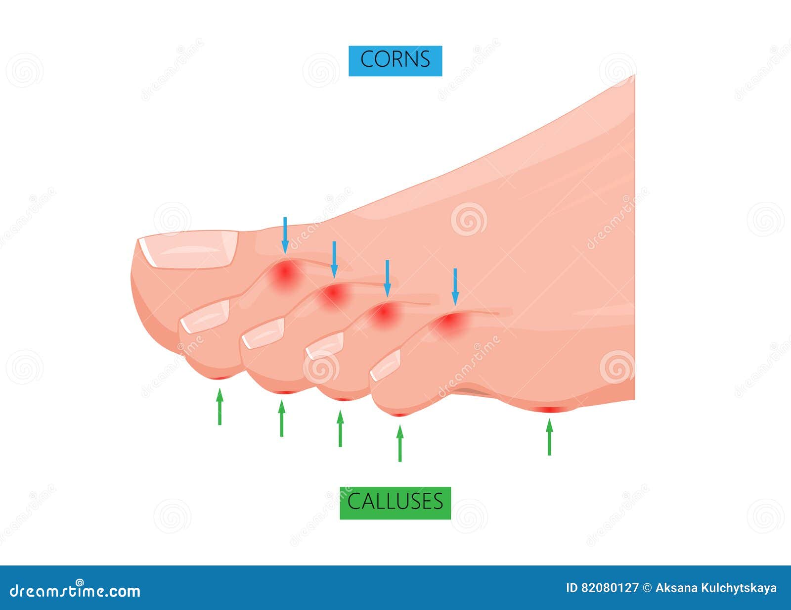 Calluses Cartoons, Illustrations & Vector Stock Images - 127 Pictures ...