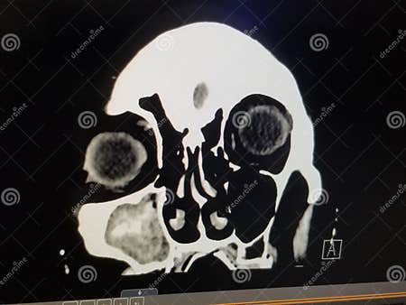 Coronal CT Scan of the Sinuses and Face - Right Maxillary Sinusitis ...