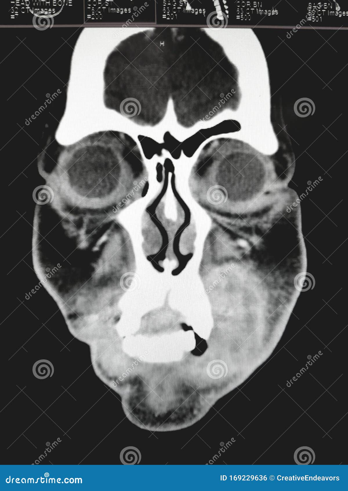 Coronal CT Scan Van De Sinussen En Het Gezicht Stock Foto - Image of ...
