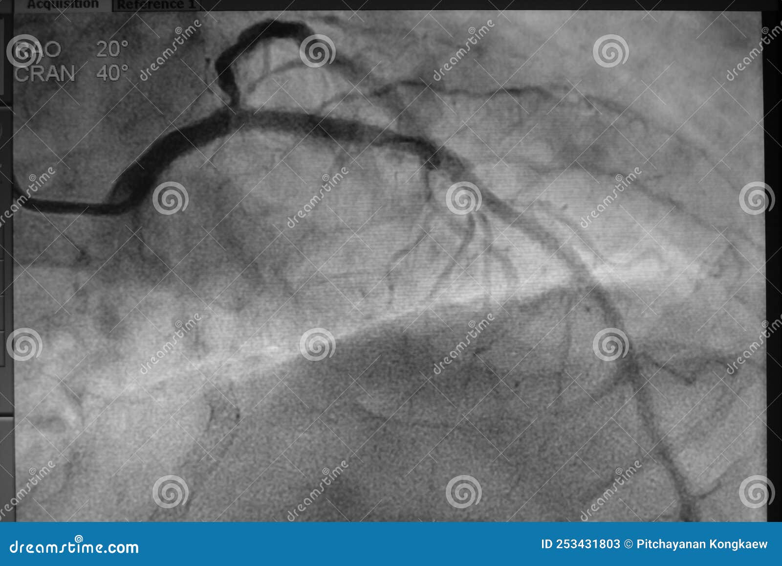 Coronary angiogram stock image. Image of cardiovascular - 253431803
