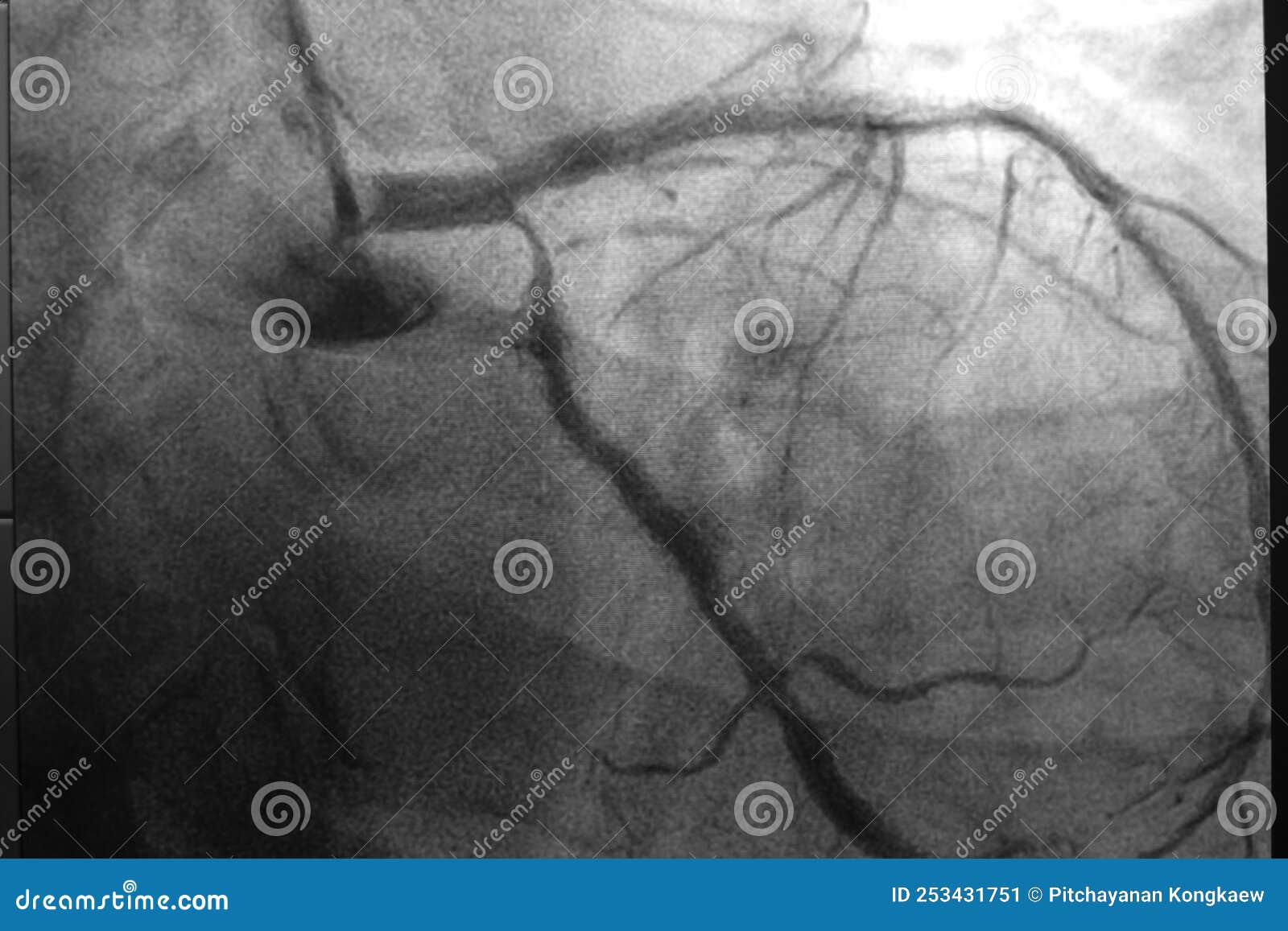 Coronary angiogram stock image. Image of chest, health - 253431751