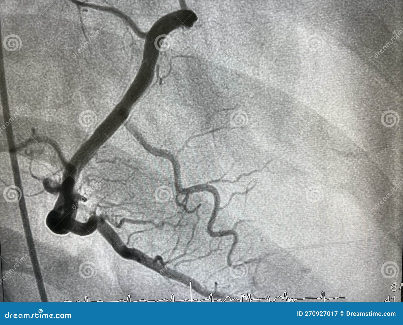 Coronary Angiogram Stock Image | CartoonDealer.com #244331287