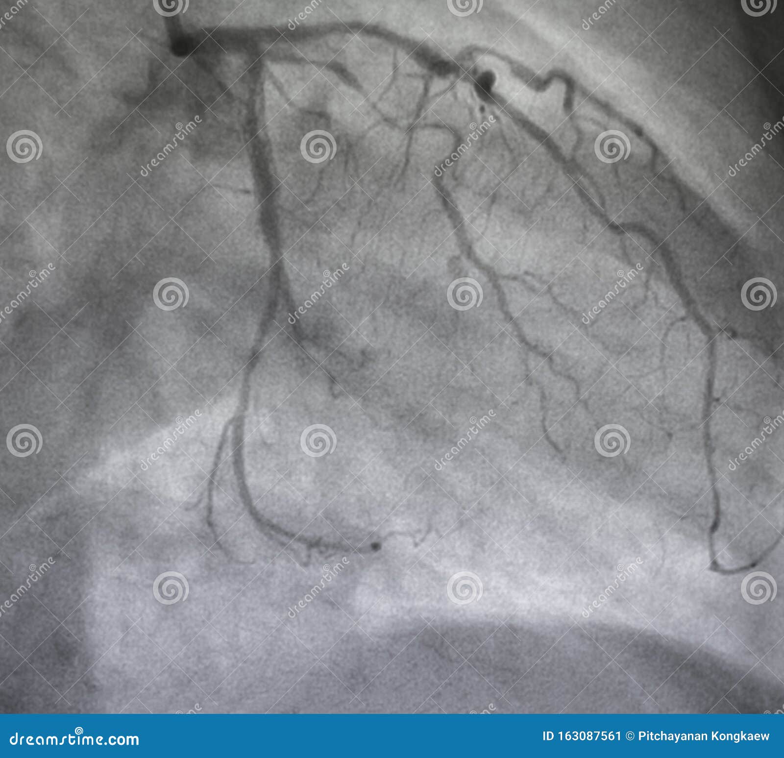 Coronary Angiography. Left Coronary Angiography. Stock Image - Image of ...