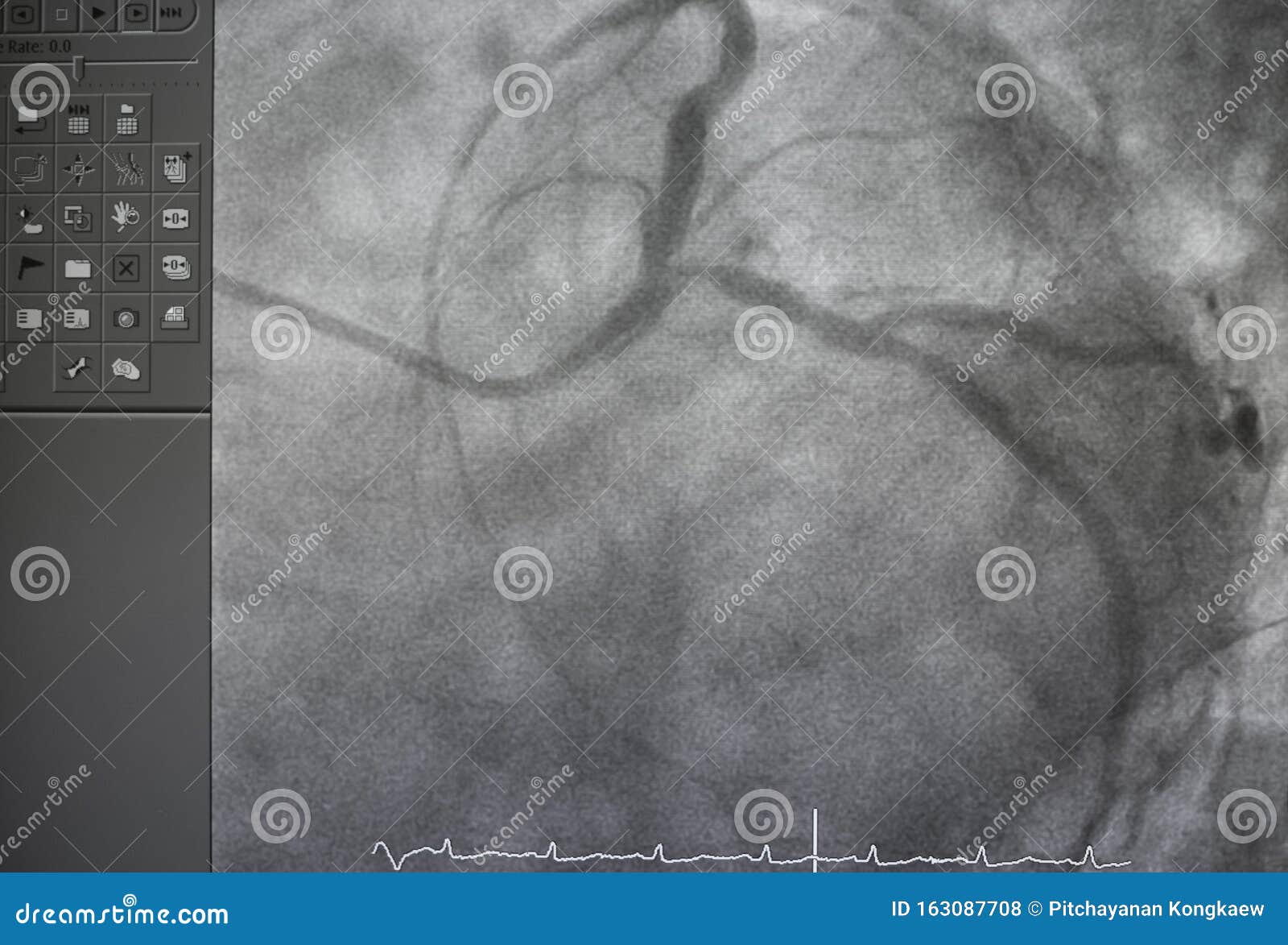 Coronary Angiography. Left Coronary Angiography. Stock Photo - Image of ...