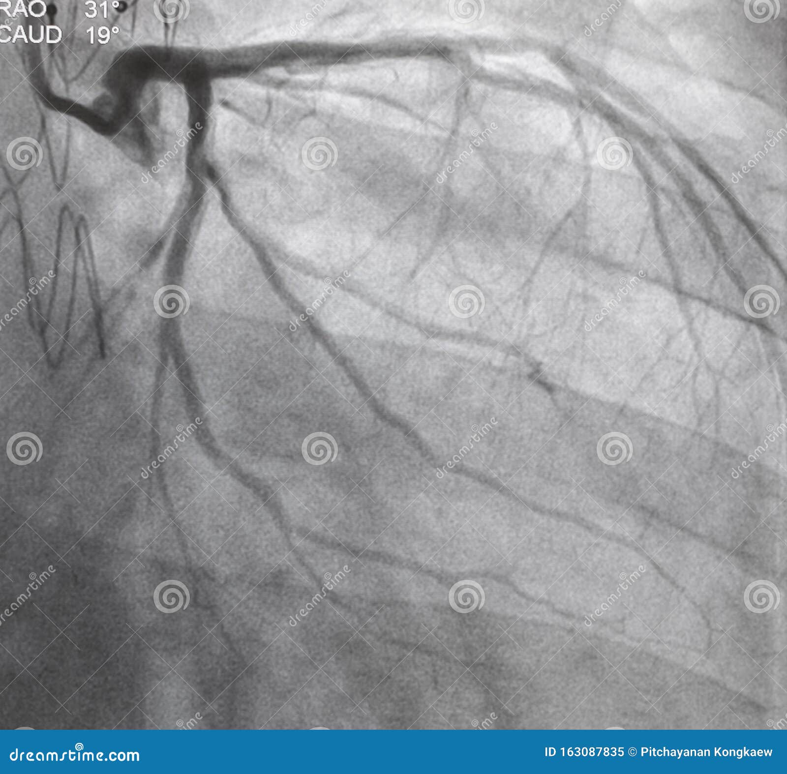 Coronary Angiography. Left Coronary Angiography. Stock Image - Image of ...