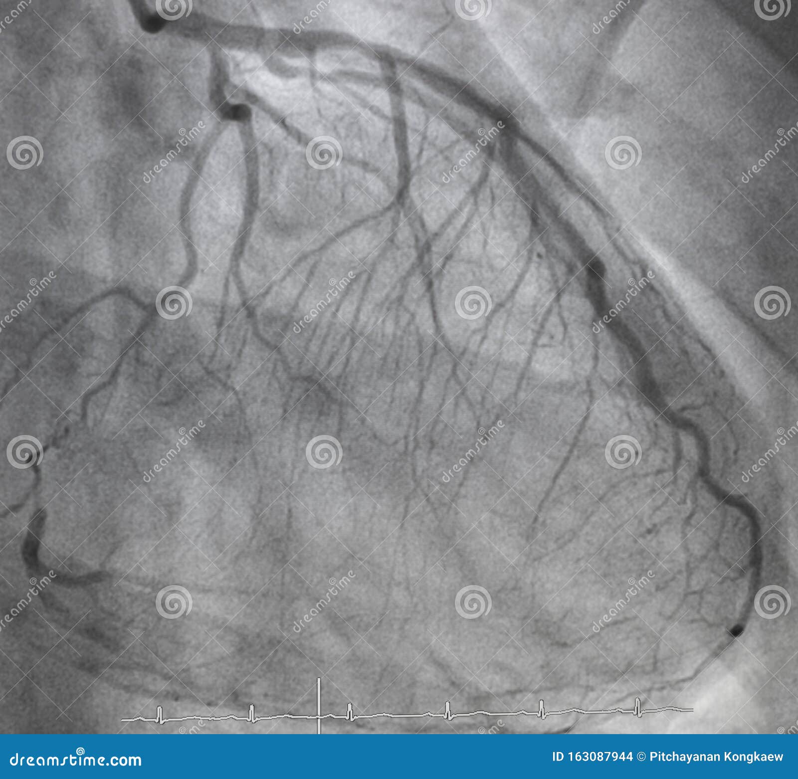 Coronary Angiography. Left Coronary Angiography. Stock Photo - Image of ...