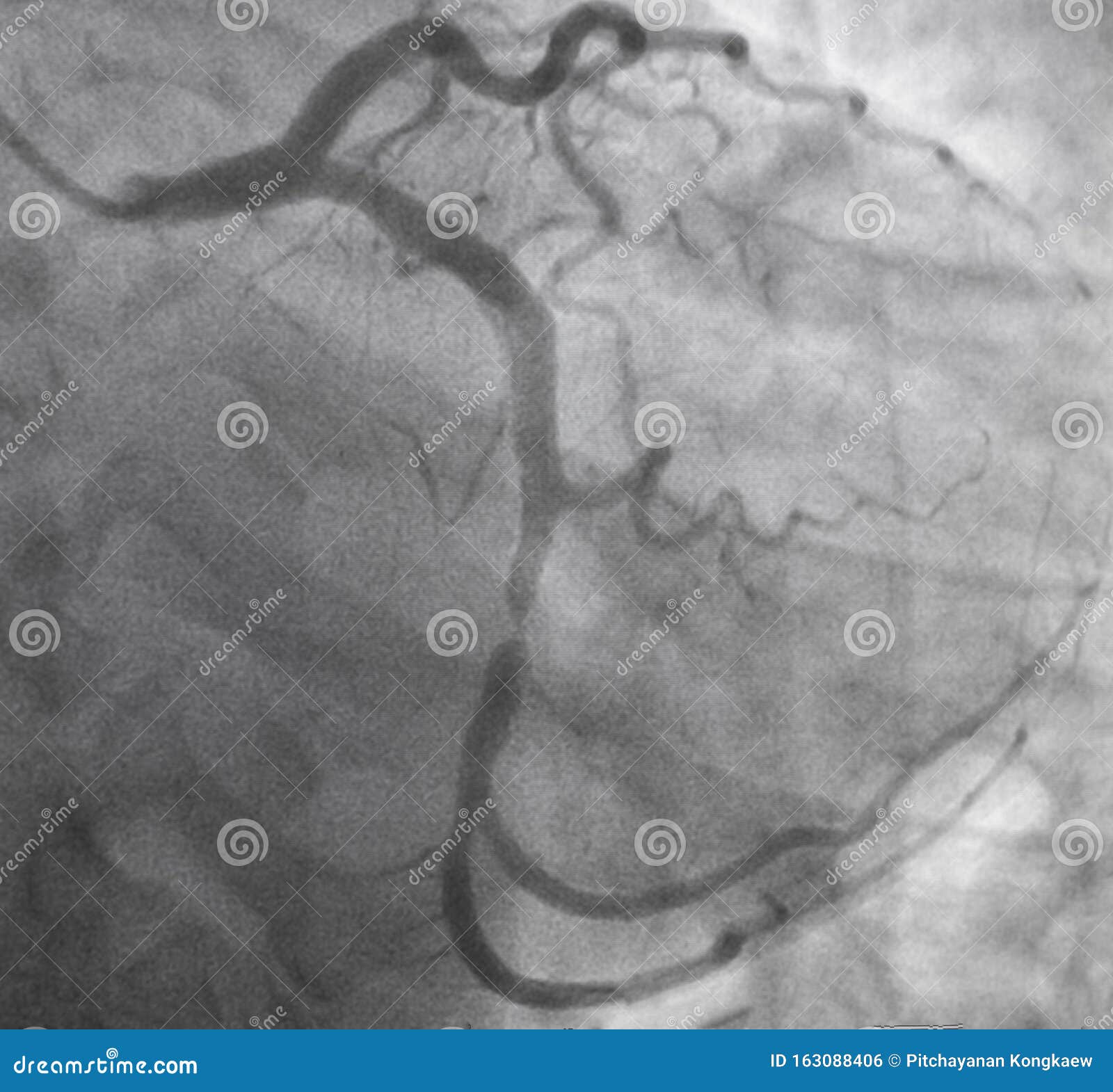 Coronary Angiography. Left Coronary Angiography. Stock Photo - Image of ...