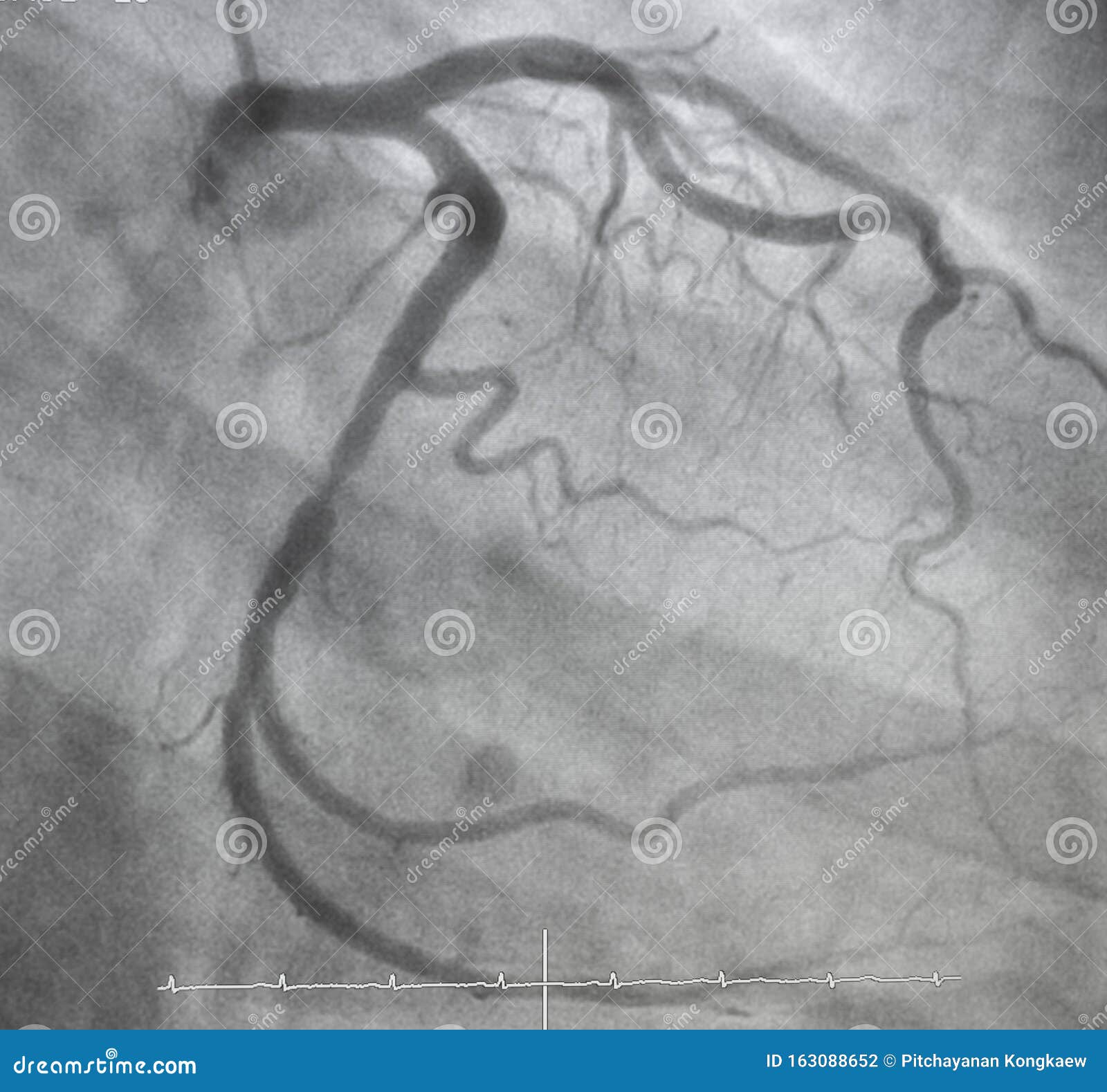 Coronary Angiography. Left Coronary Angiography. Stock Photo - Image of ...