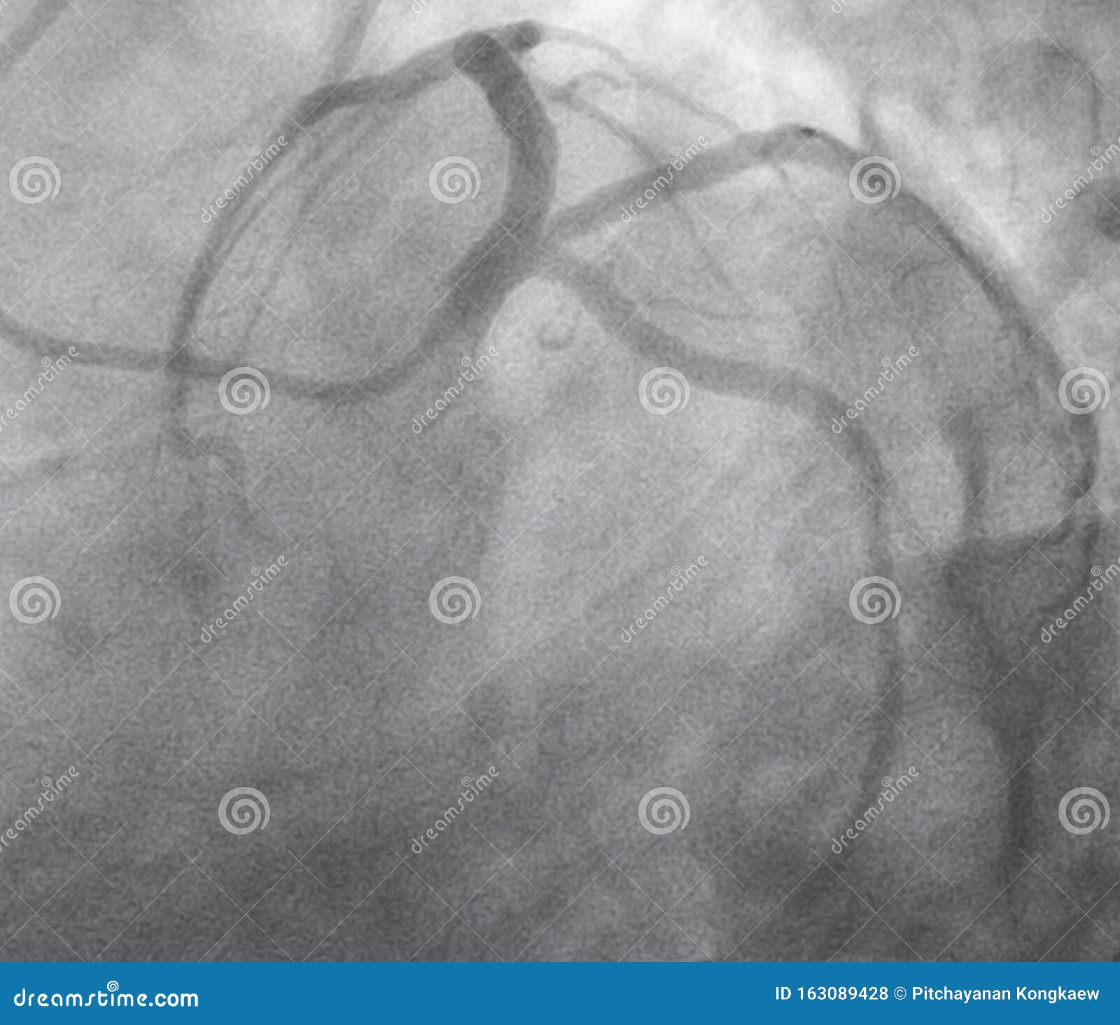 Coronary Angiography. Left Coronary Angiography. Stock Photo - Image of ...