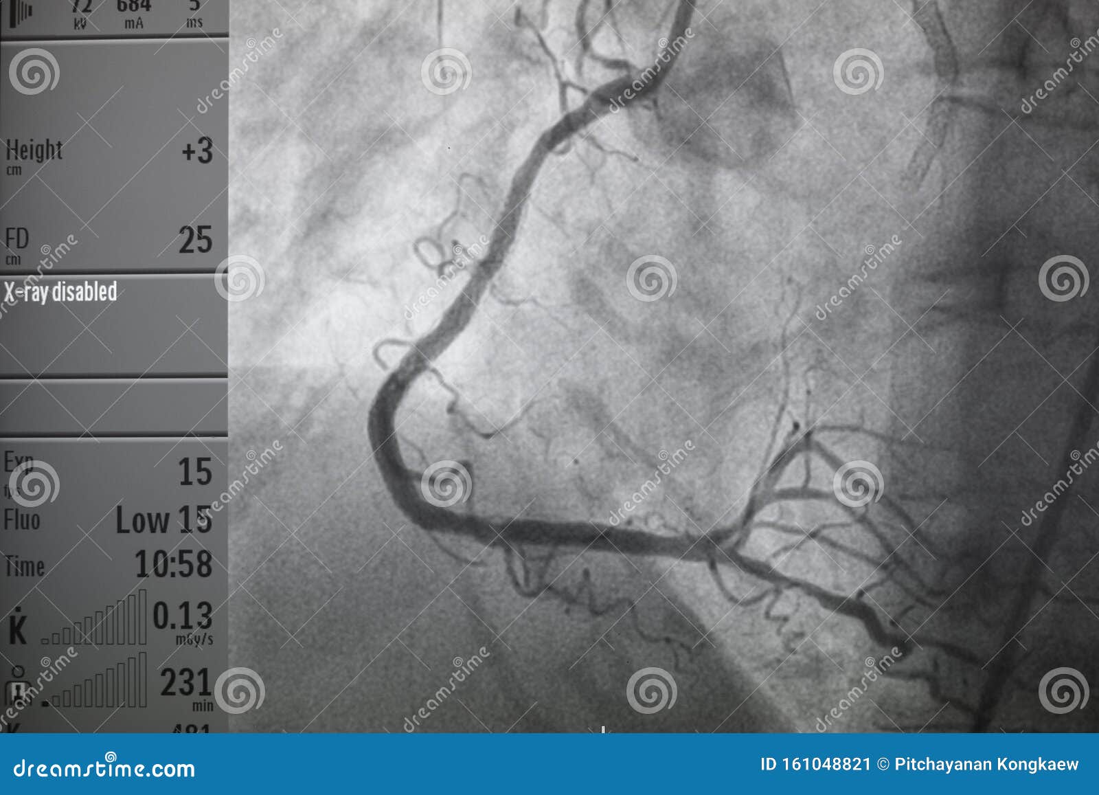 Coronary angiography. stock image. Image of right, artery - 161048821