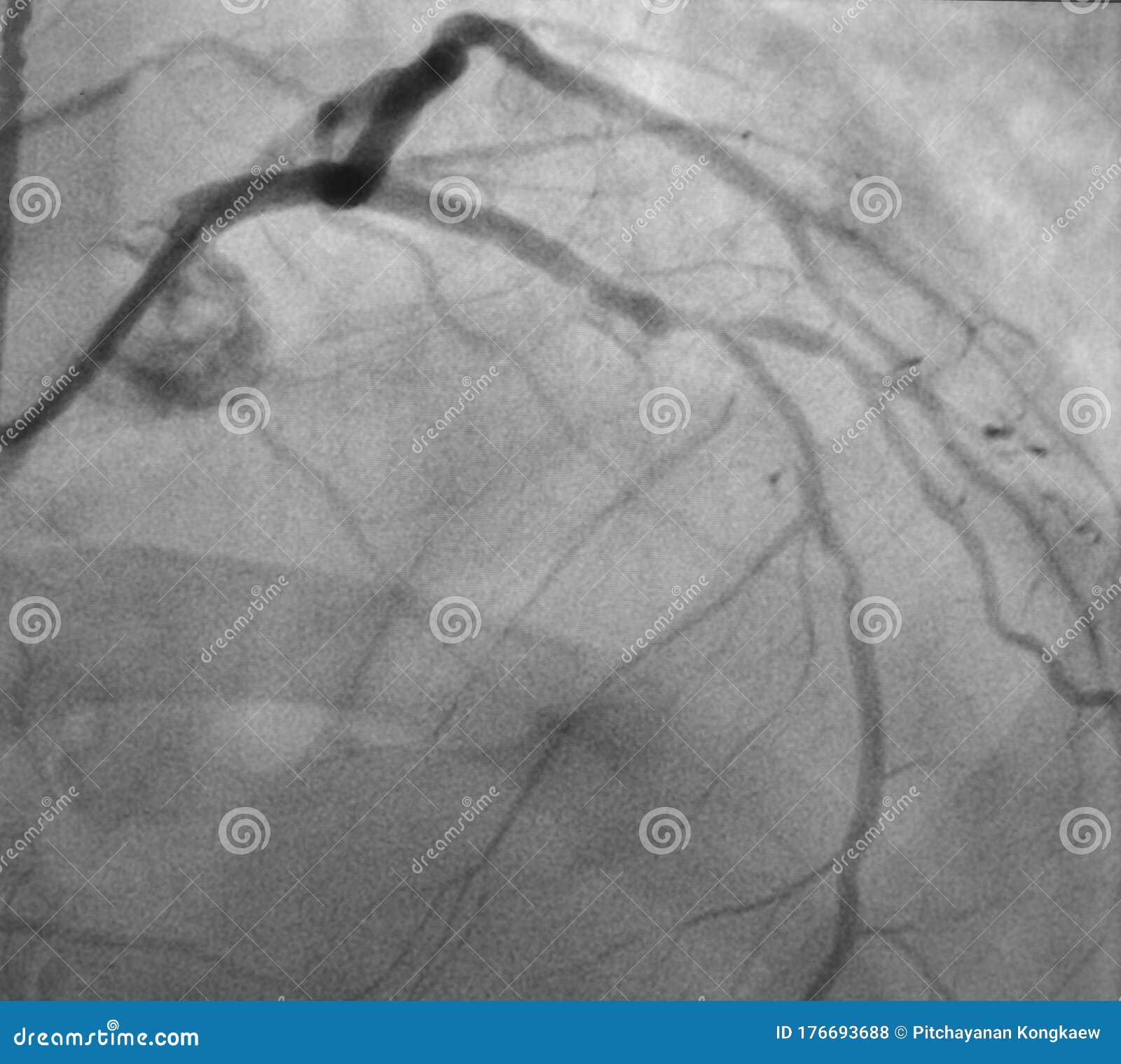 Coronary Angiography. X-ray Image. Stock Illustration - Illustration of ...