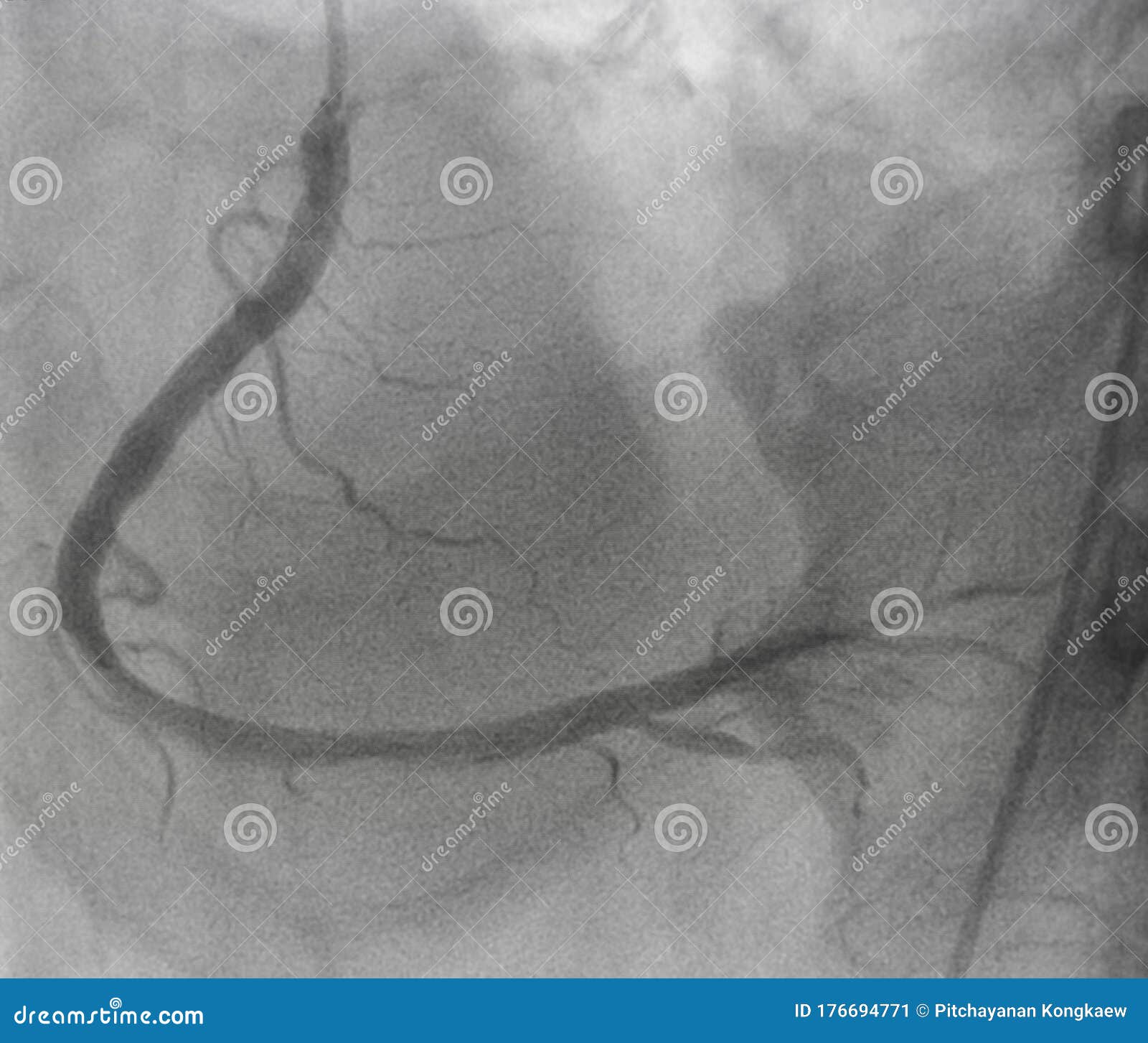 Coronary Angiography. X-ray Image. Stock Illustration - Illustration of ...