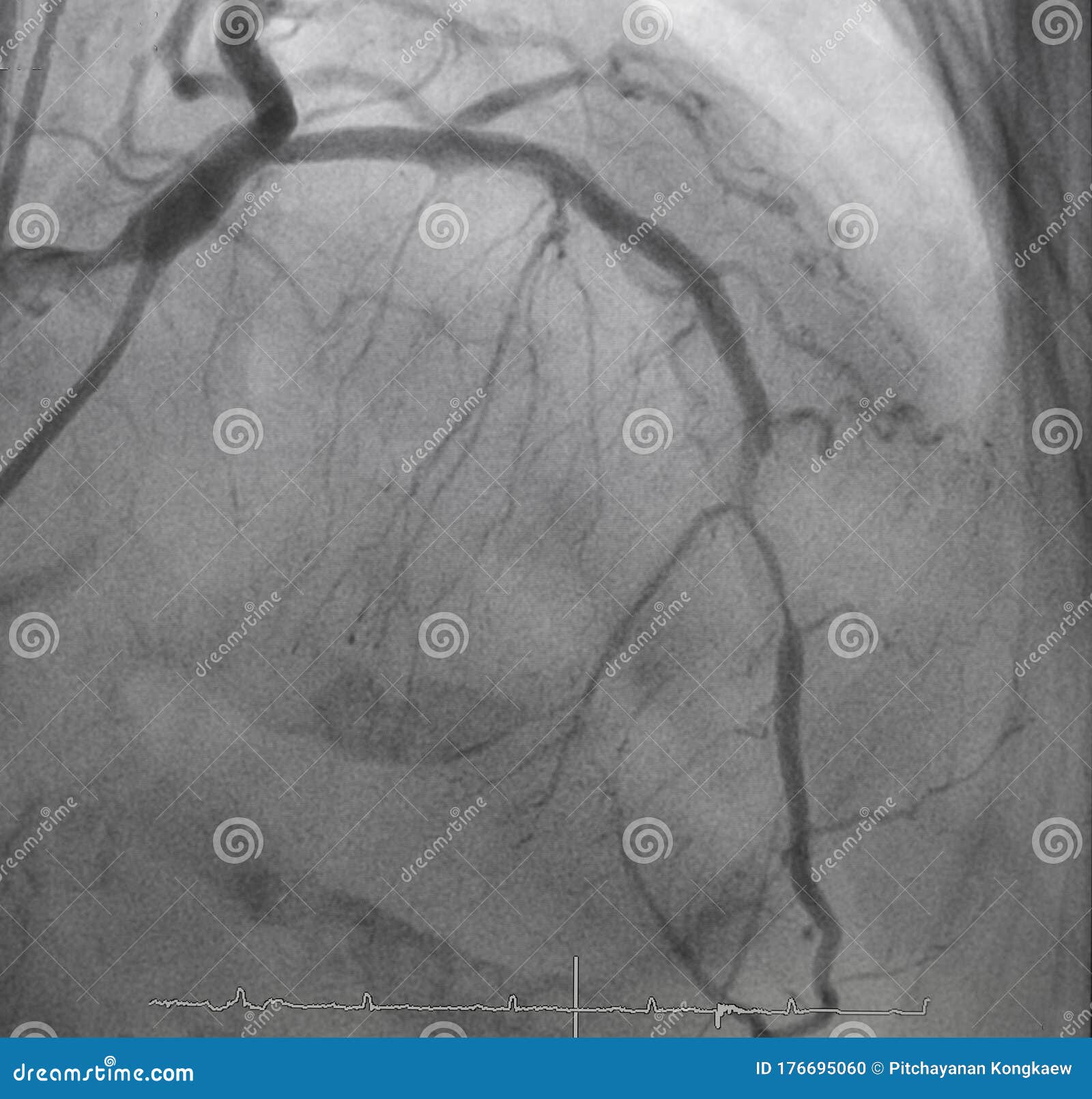 Coronary Angiography. X-ray Image. Stock Illustration - Illustration of ...