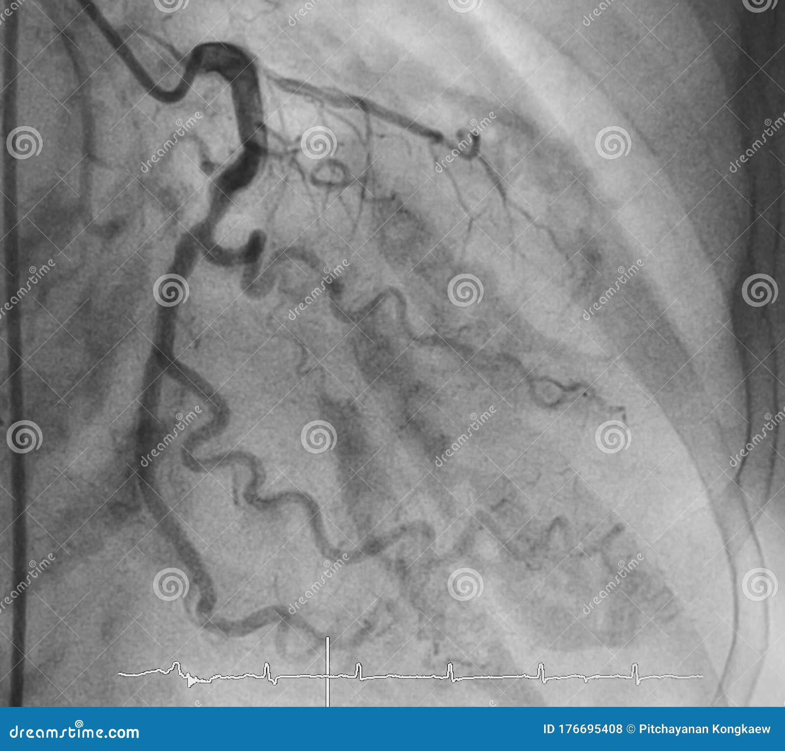 Coronary Angiography. X-ray Image. Stock Illustration - Illustration of ...