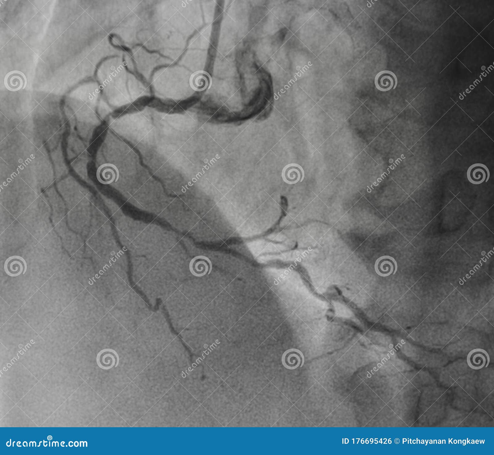 Coronary Angiography. X-ray Image. Stock Illustration - Illustration of ...