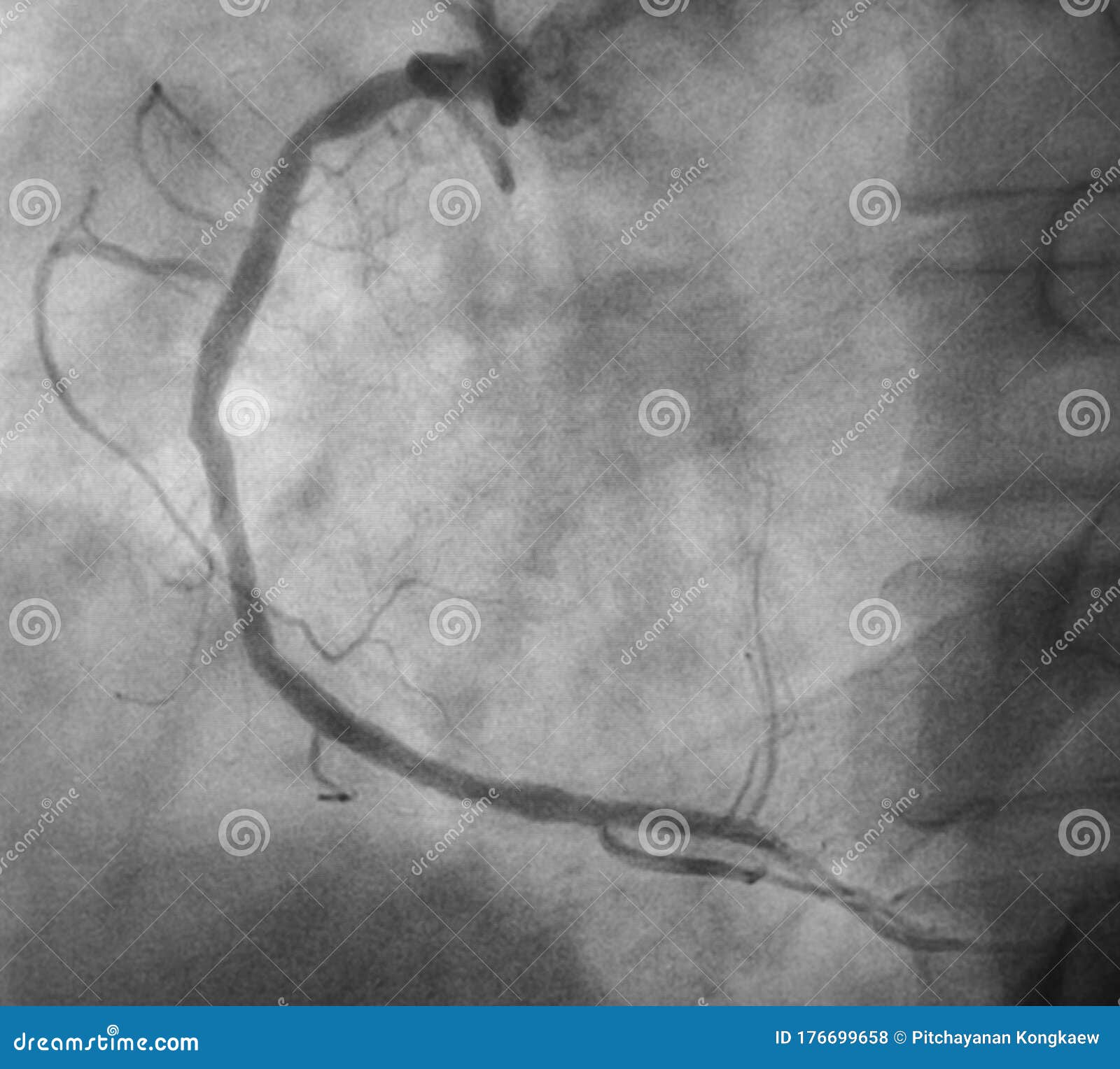 Coronary Angiography. X-ray Image. Stock Illustration - Illustration of ...