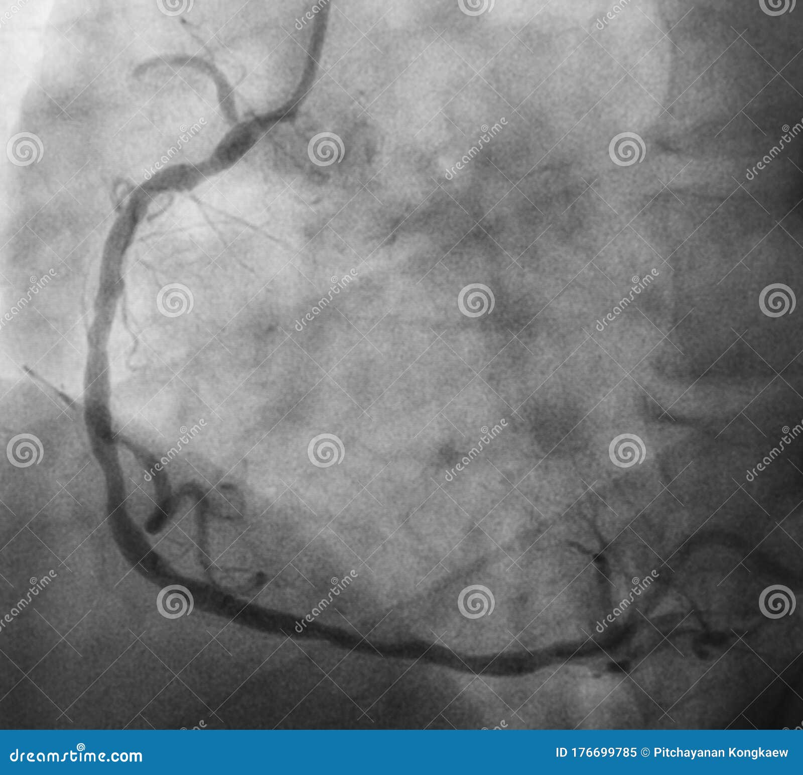 Coronary Angiography. X-ray Image. Stock Illustration - Illustration of ...