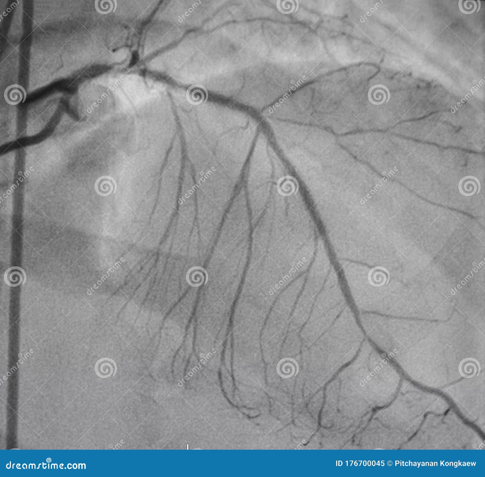 Coronary Angiography. X-ray Image. Stock Illustration - Illustration of ...