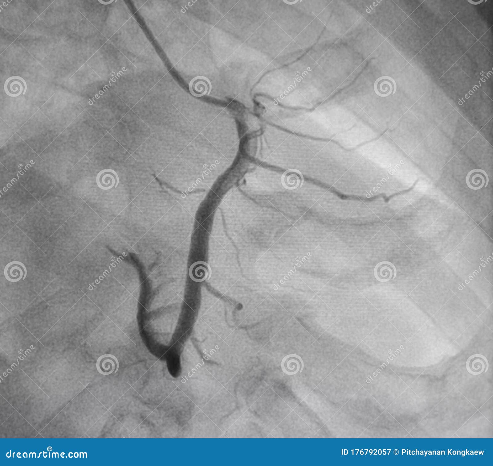 Coronary Angiography. X-ray Image. Stock Illustration - Illustration of ...