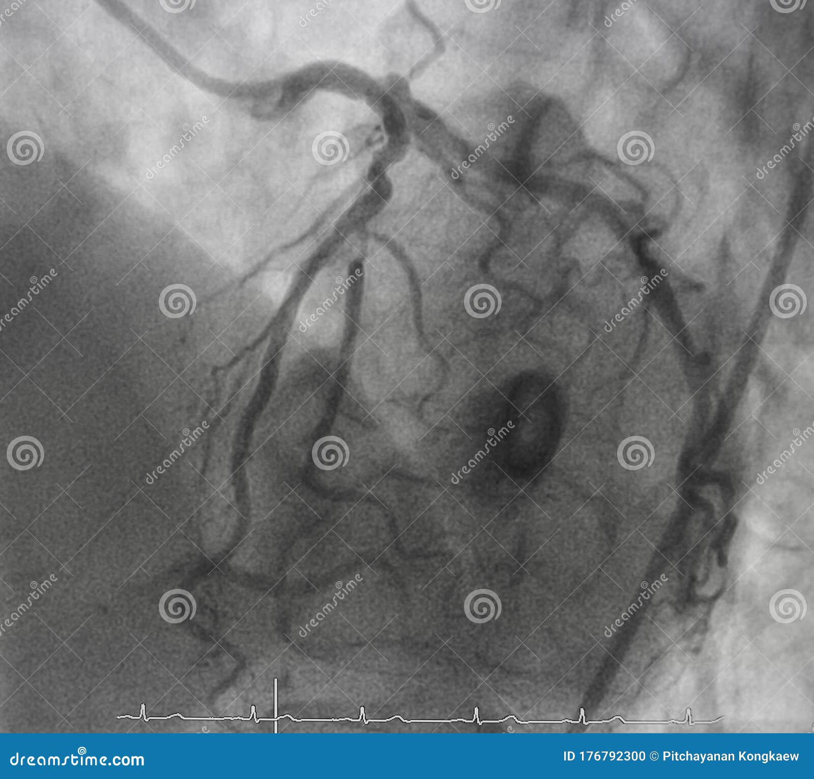 Coronary Angiography. X-ray Image. Stock Illustration - Illustration of ...