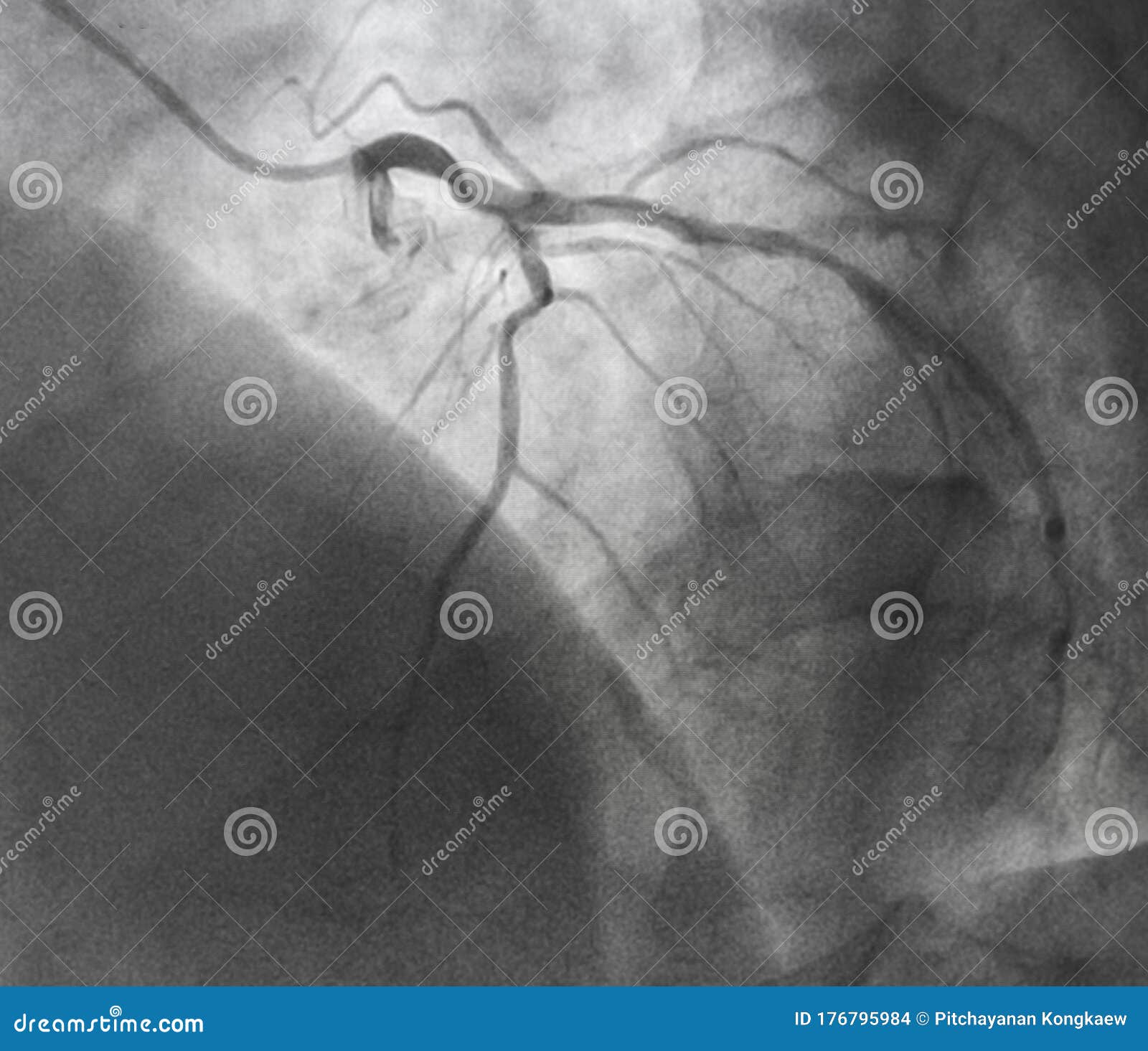 Coronary Angiography. X-ray Image. Stock Illustration - Illustration of ...