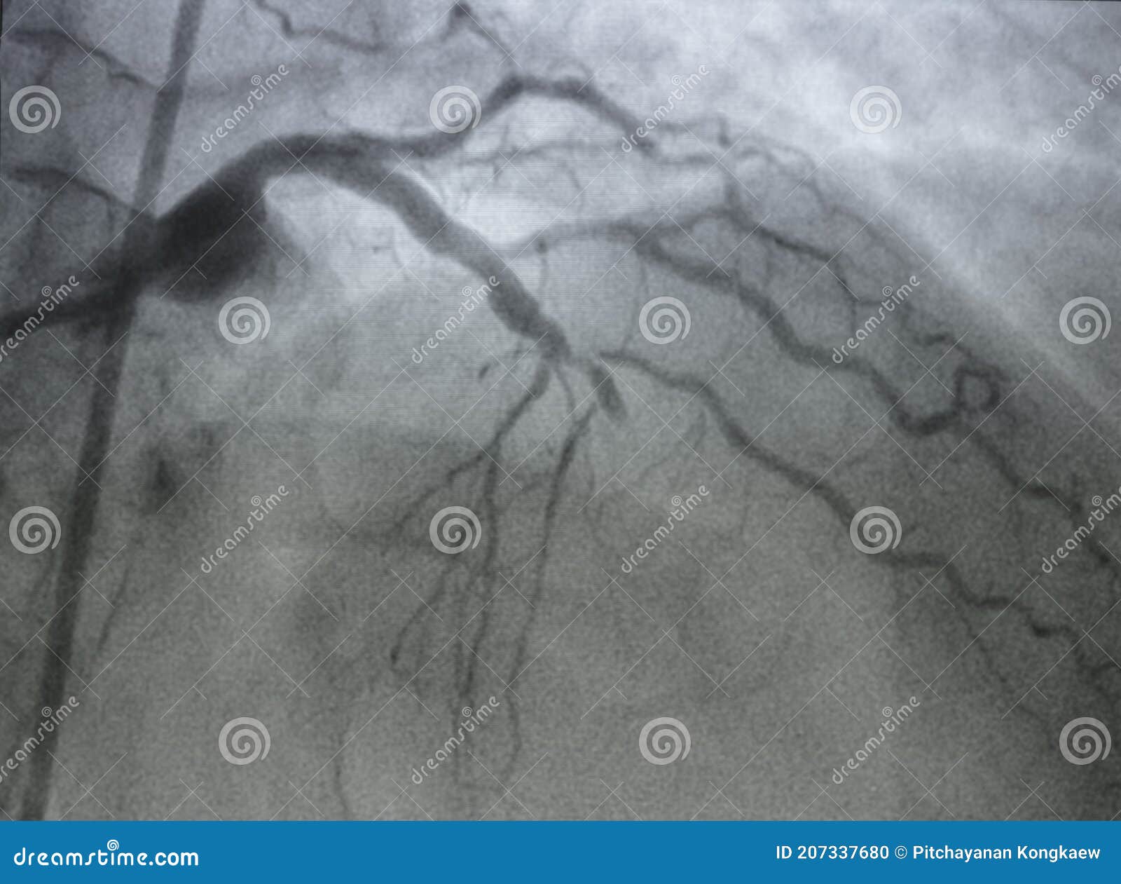Coronary Angiography. X-ray Image Stock Photo - Image of imaging ...