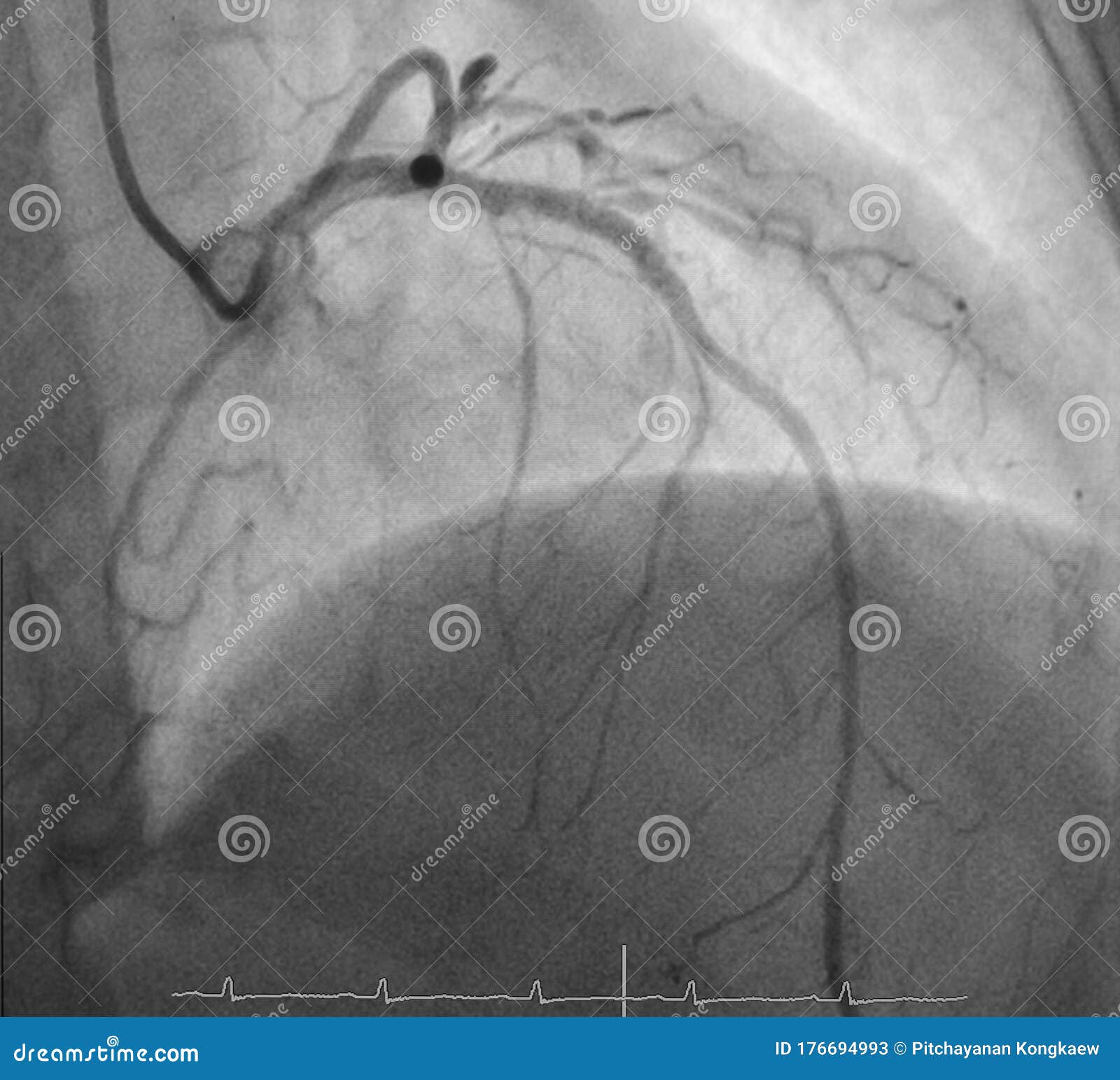 Coronary Angiography. X-ray Image. Stock Illustration - Illustration of ...
