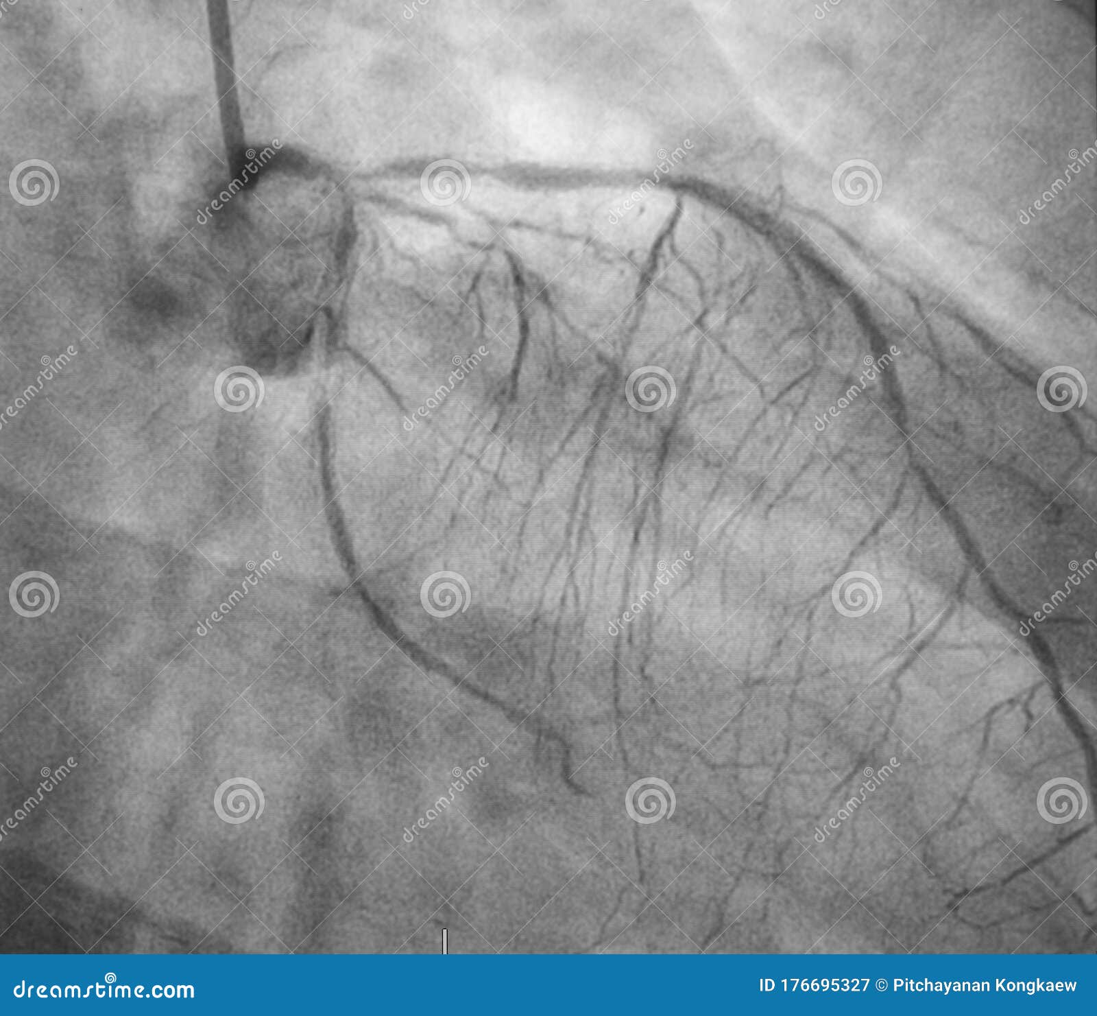 Coronary Angiography. X-ray Image. Stock Illustration - Illustration of ...