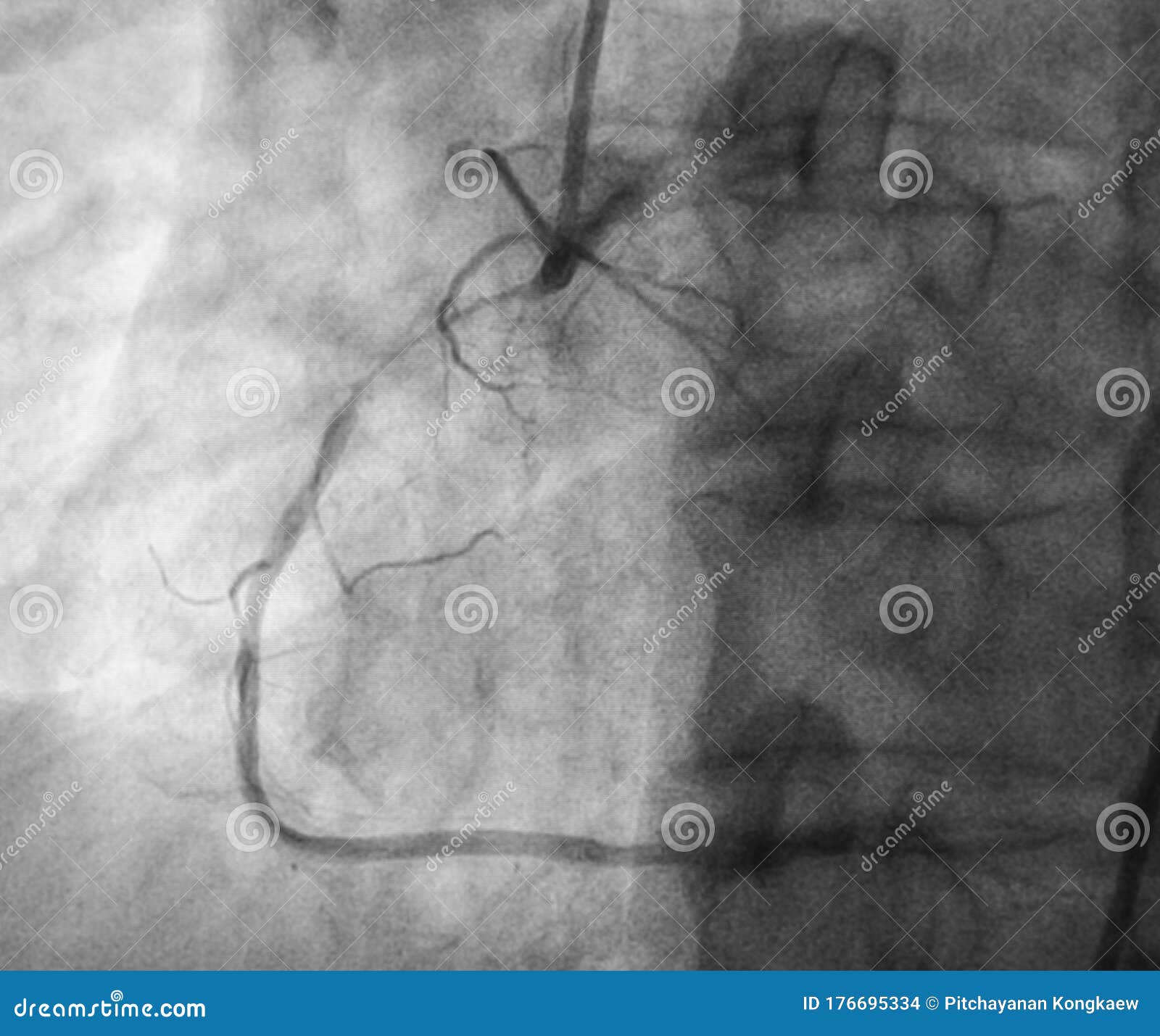Coronary Angiography. X-ray Image. Stock Illustration - Illustration of ...