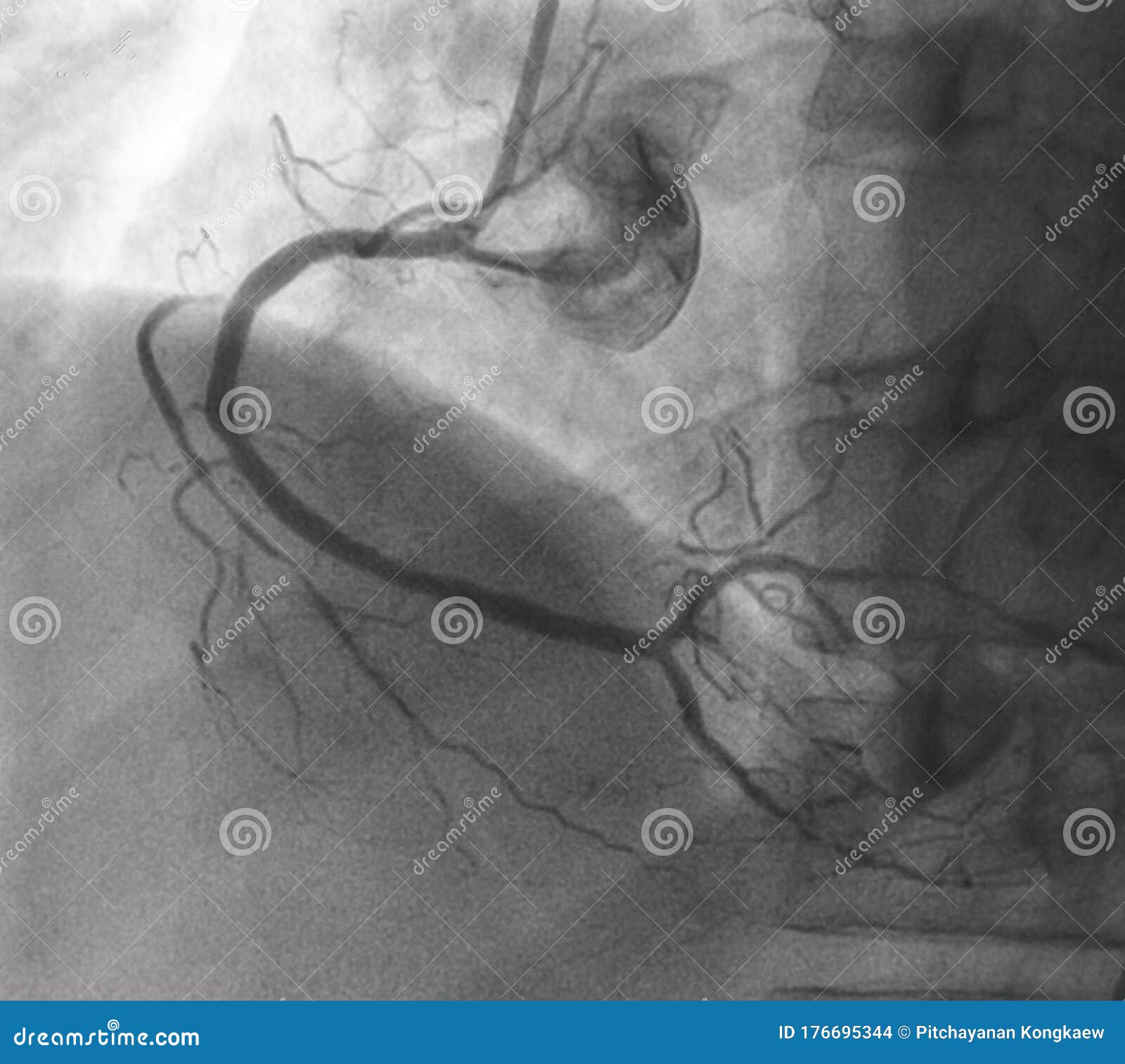 Coronary Angiography. X-ray Image. Stock Illustration - Illustration of ...