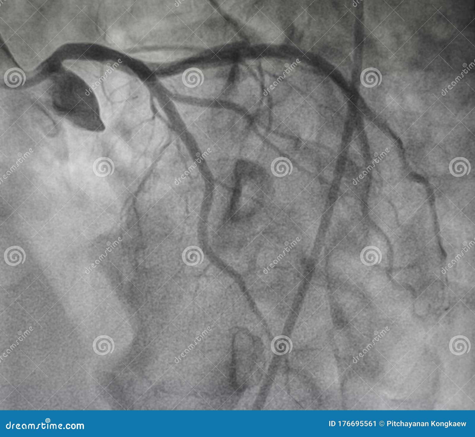 Coronary Angiography. X-ray Image. Stock Illustration - Illustration of ...