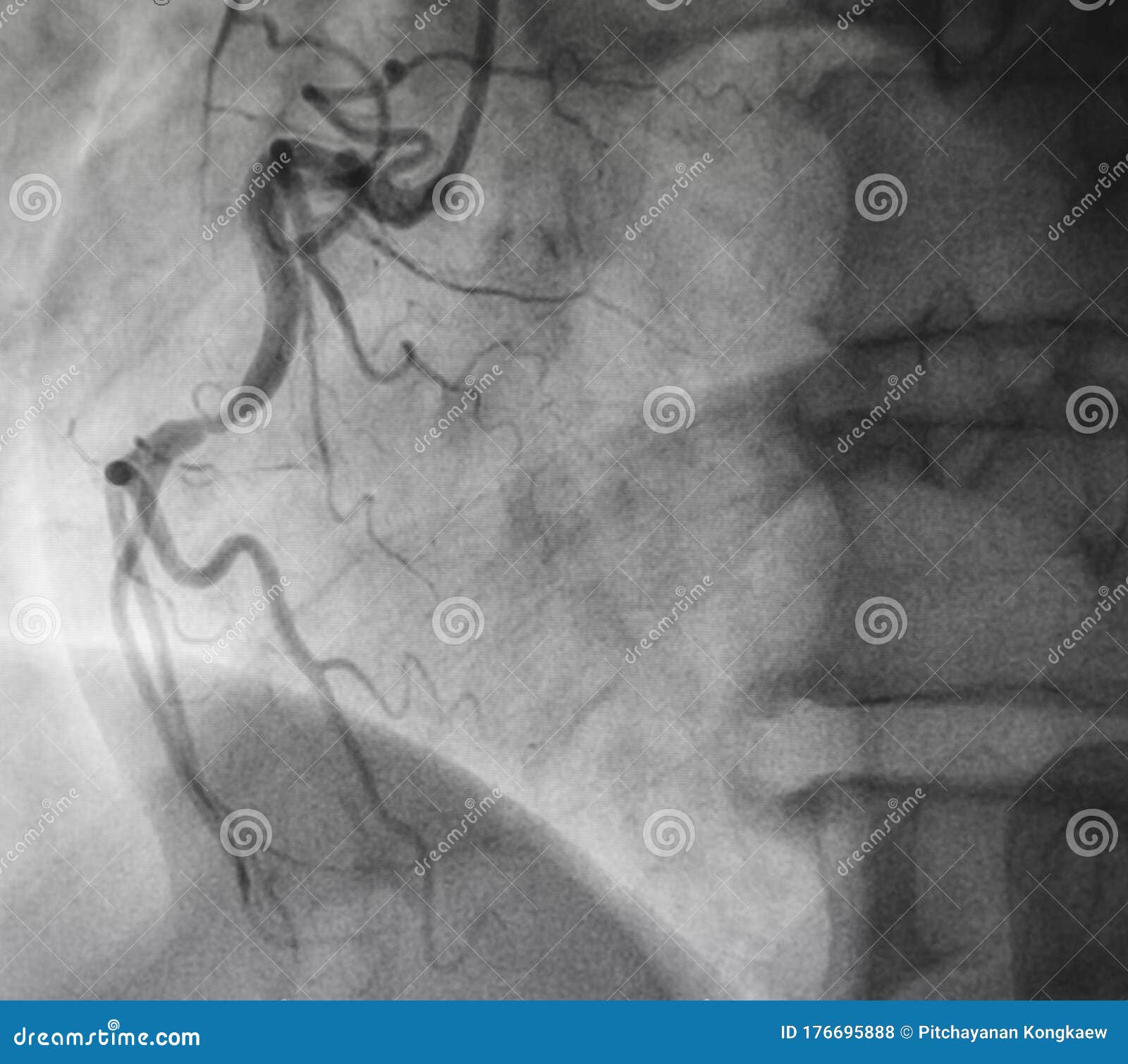 Coronary Angiography. X-ray Image. Stock Illustration - Illustration of ...