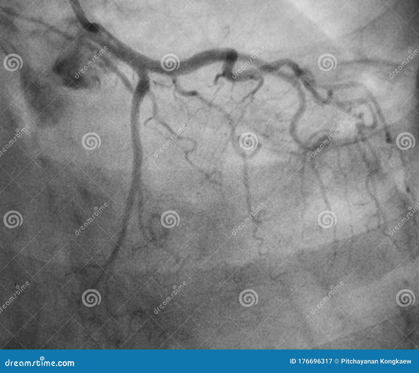 Coronary Angiography. X-ray Image. Stock Illustration - Illustration of ...